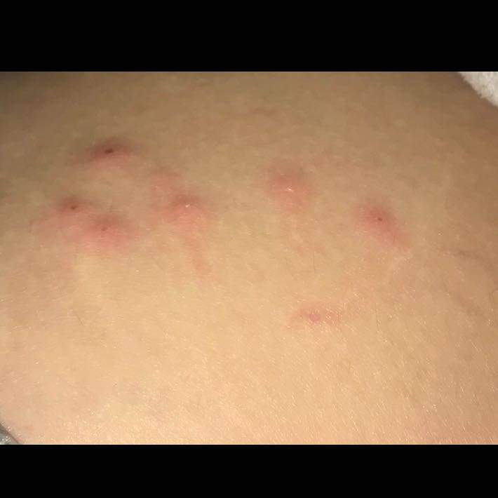 Flohstiche behandeln? (Gesundheit und Medizin, Arzt, Insekten)