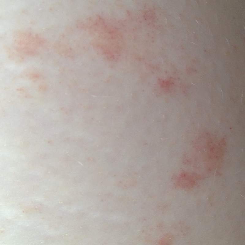 Fragen zur röschenflechte... Oder doch nicht? :o (Haut, Flecken)