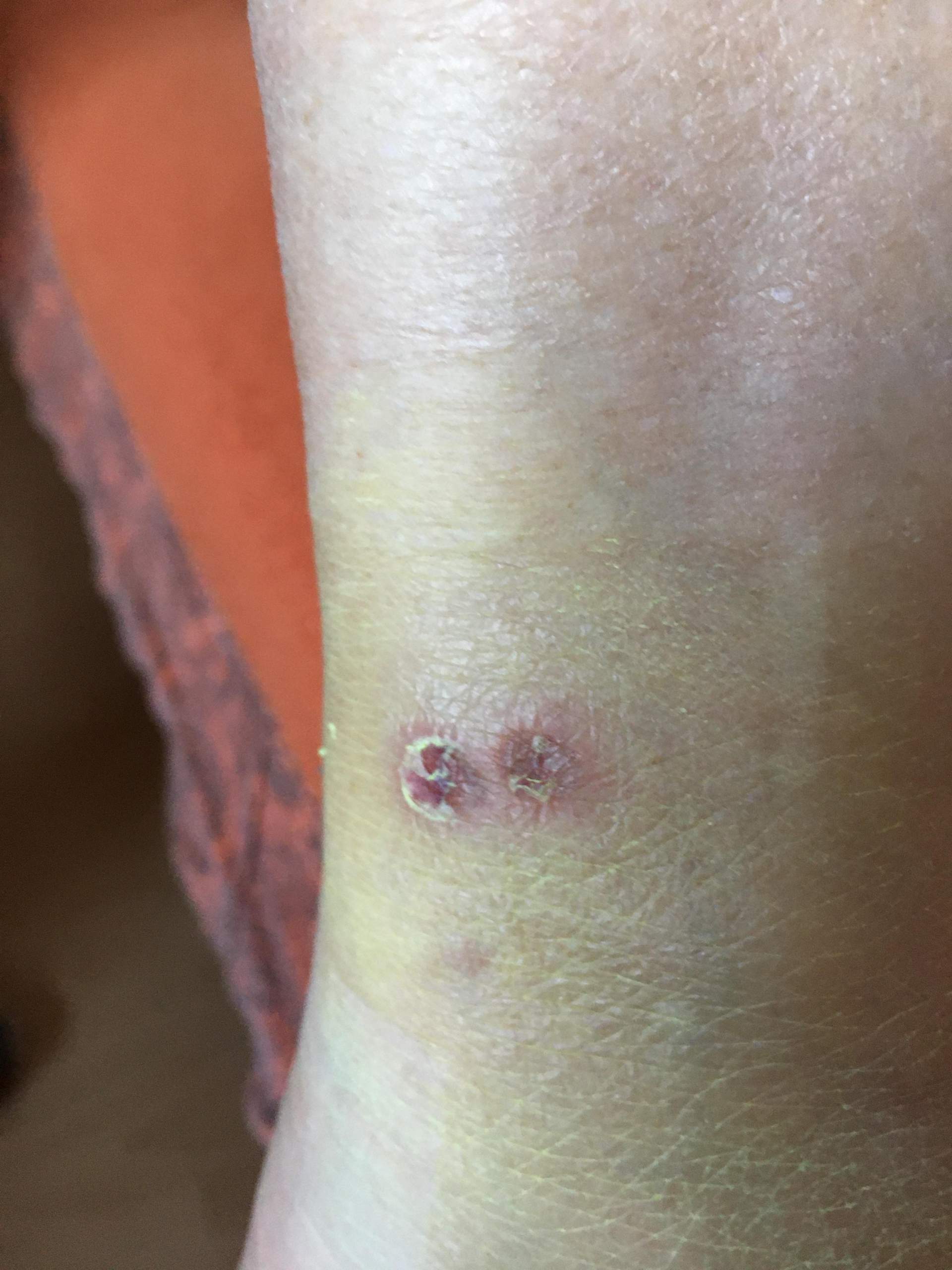 Fuß geschwollen, wer kann Stich / Biss zuordnen? (Gesundheit und Medizin)