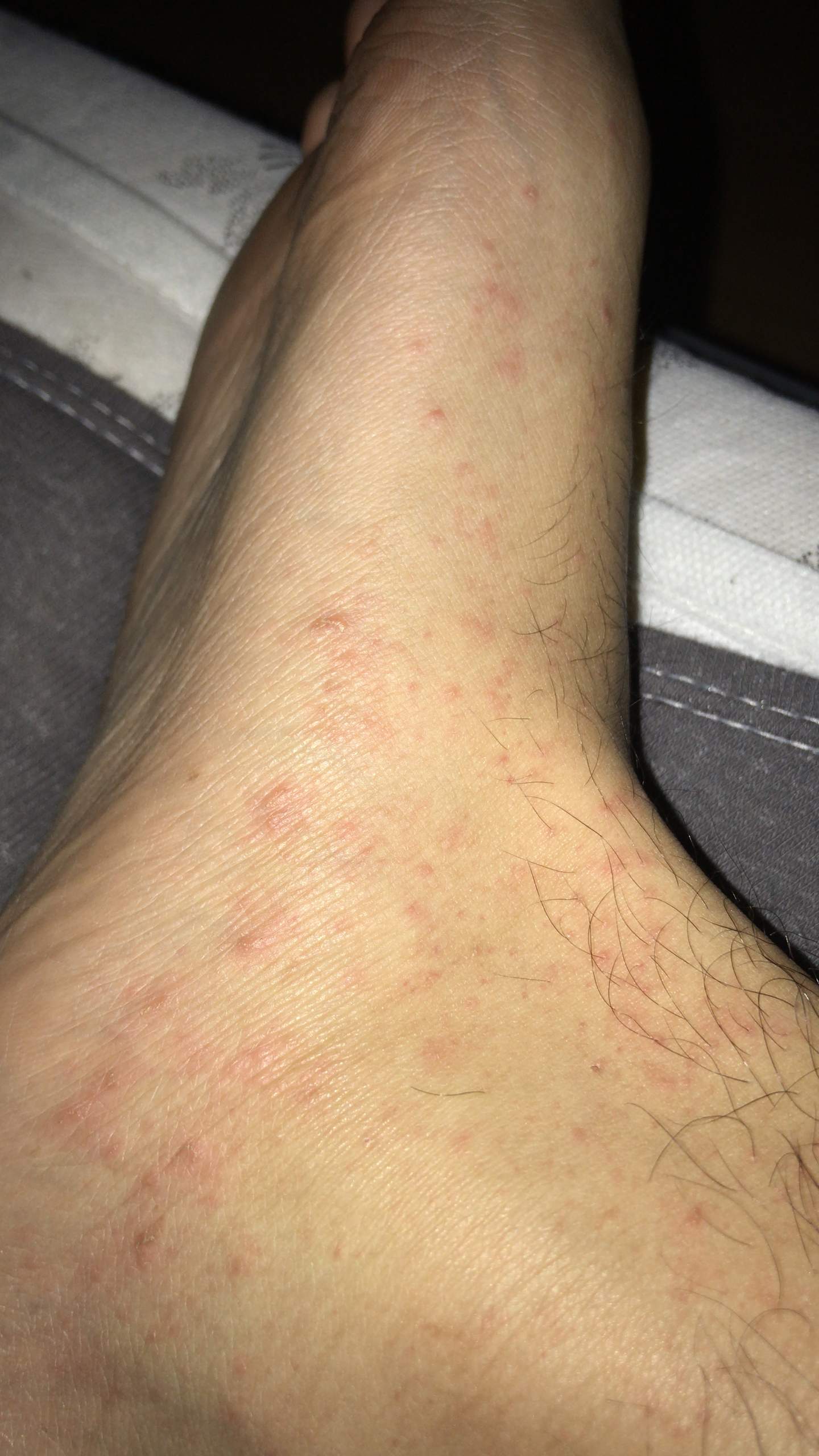 Fuß juckt was ist das hilfe? (Füße, jucken)