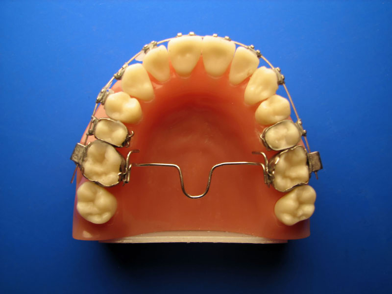 Gaumenbogen - sprechen unmöglich? (Zahnspange)