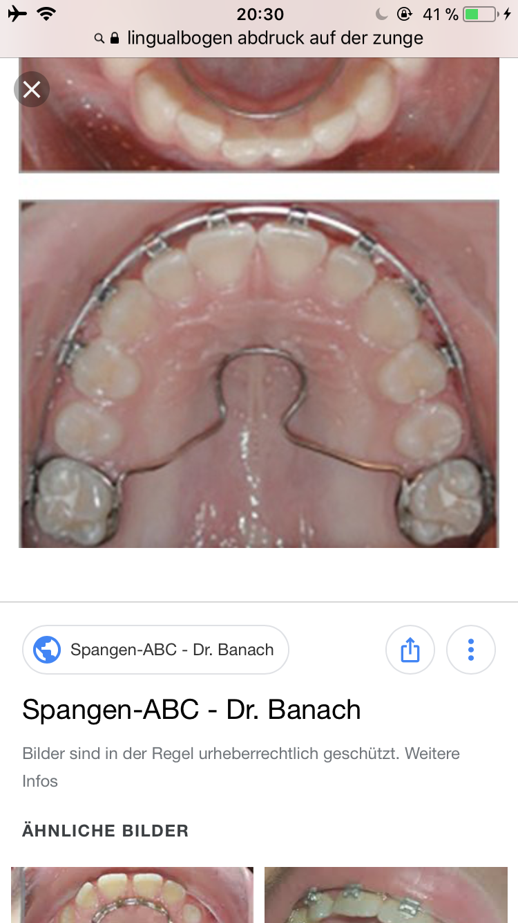 Gaumenspange, Abdruck normal? (Gesundheit und Medizin, Zähne, Zahnarzt)
