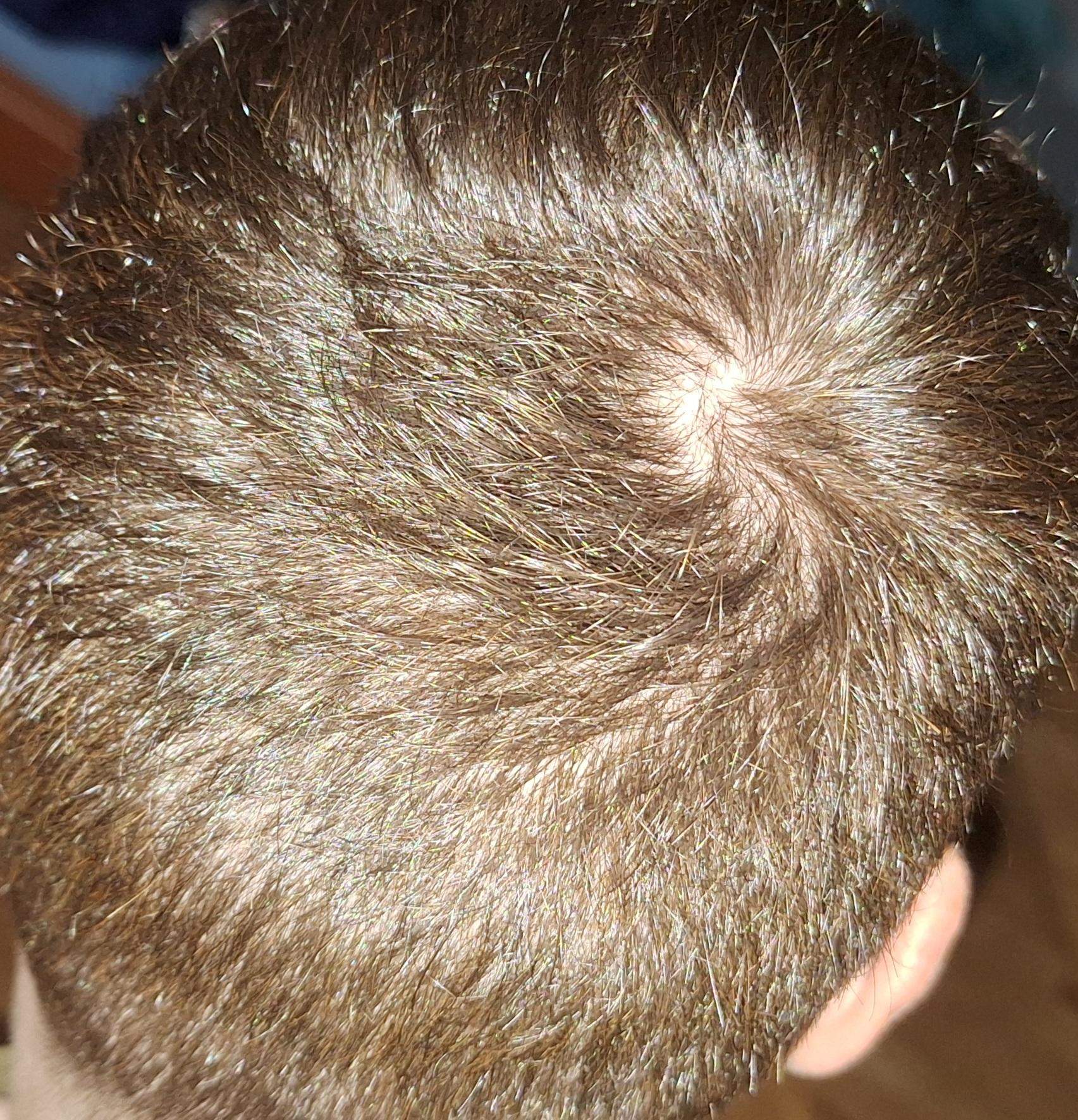 Gehen mir die Haare aus? (Mädchen, Gesundheit, Frauen)