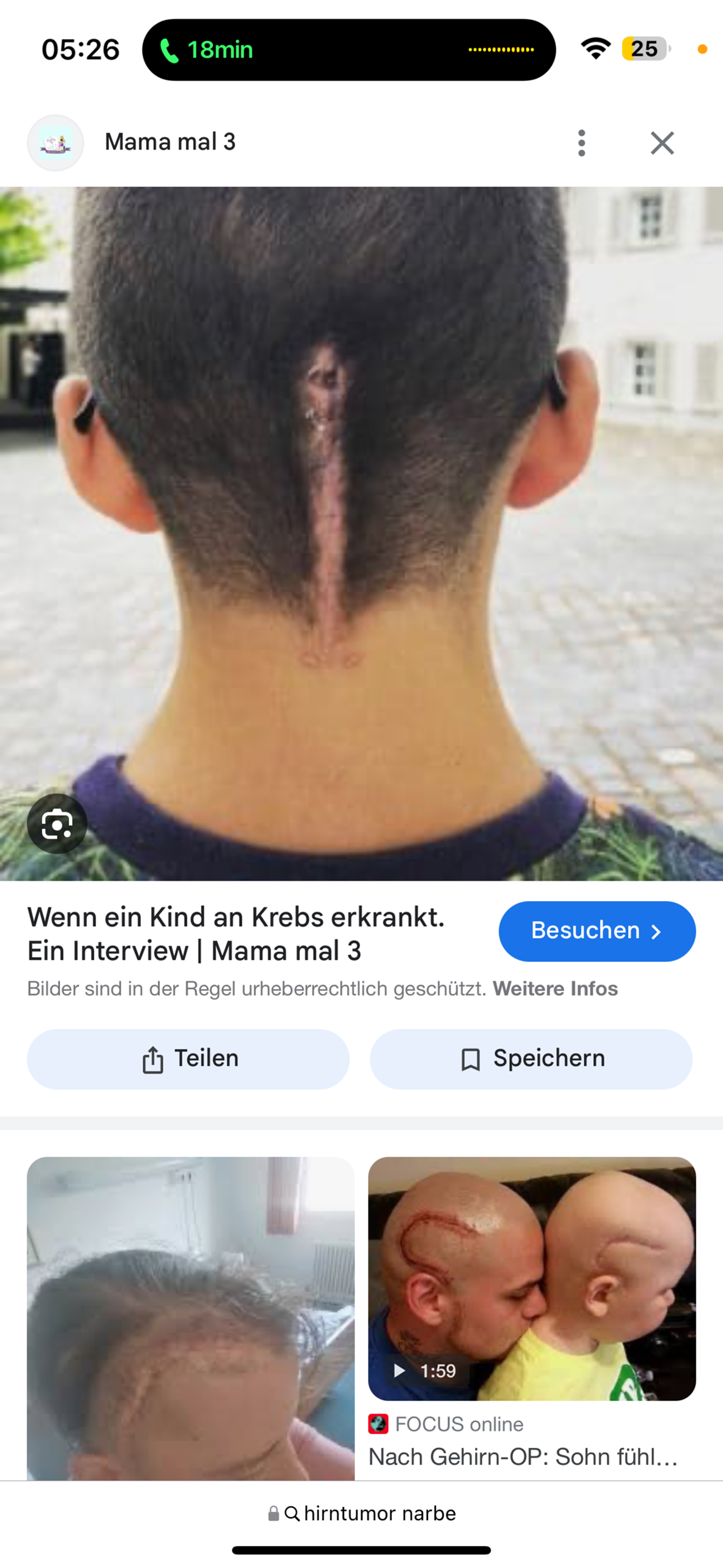 Geht eine Haartransplantation auf einer Narbe am Hinterkopf? (Mädchen ...