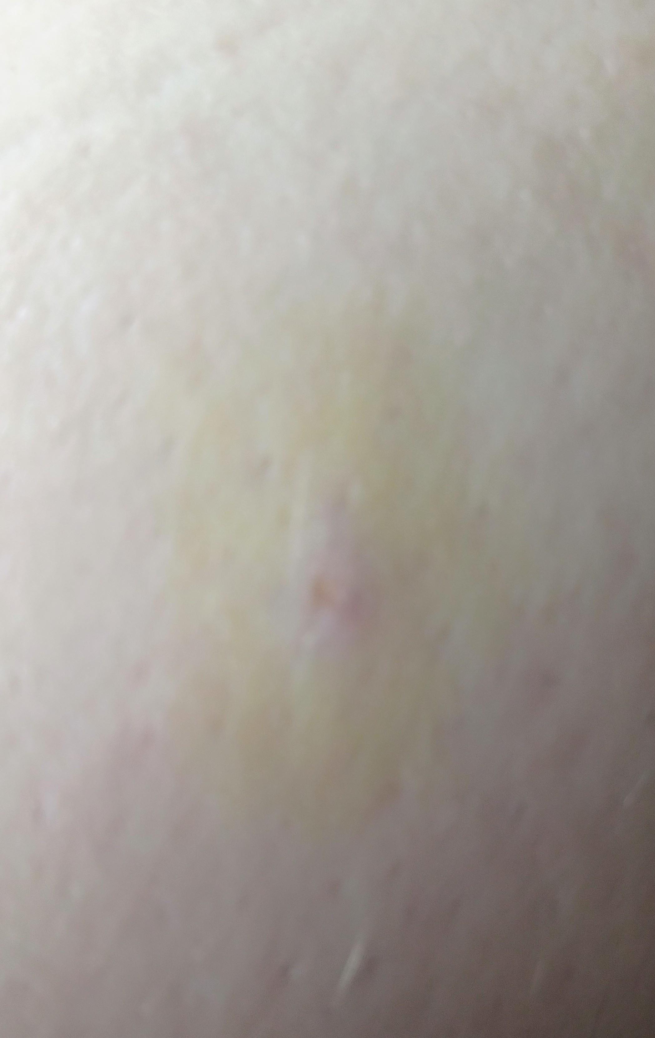 Gelber Fleck Auf Der Haut