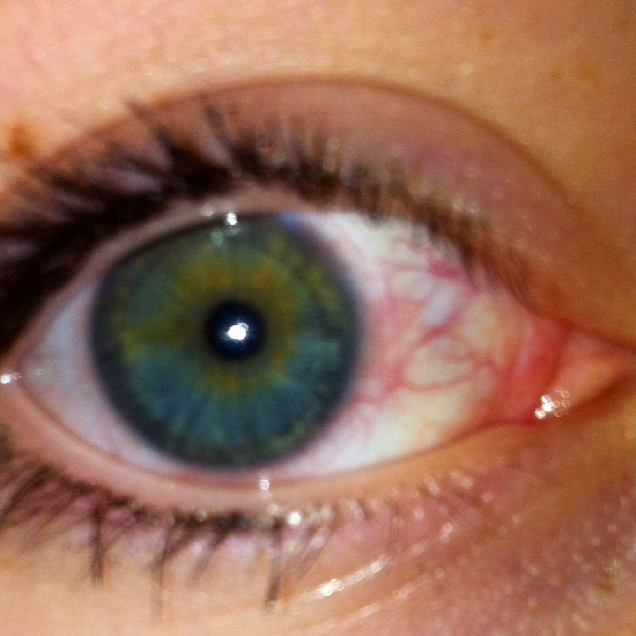 Gereiztes, rotes Auge (Gesundheit, Augen)