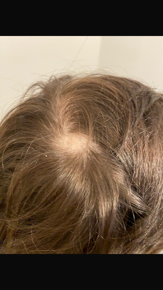 glatze! hilfe! nur an einer stelle. mitten an meinem hinterkopf was ...