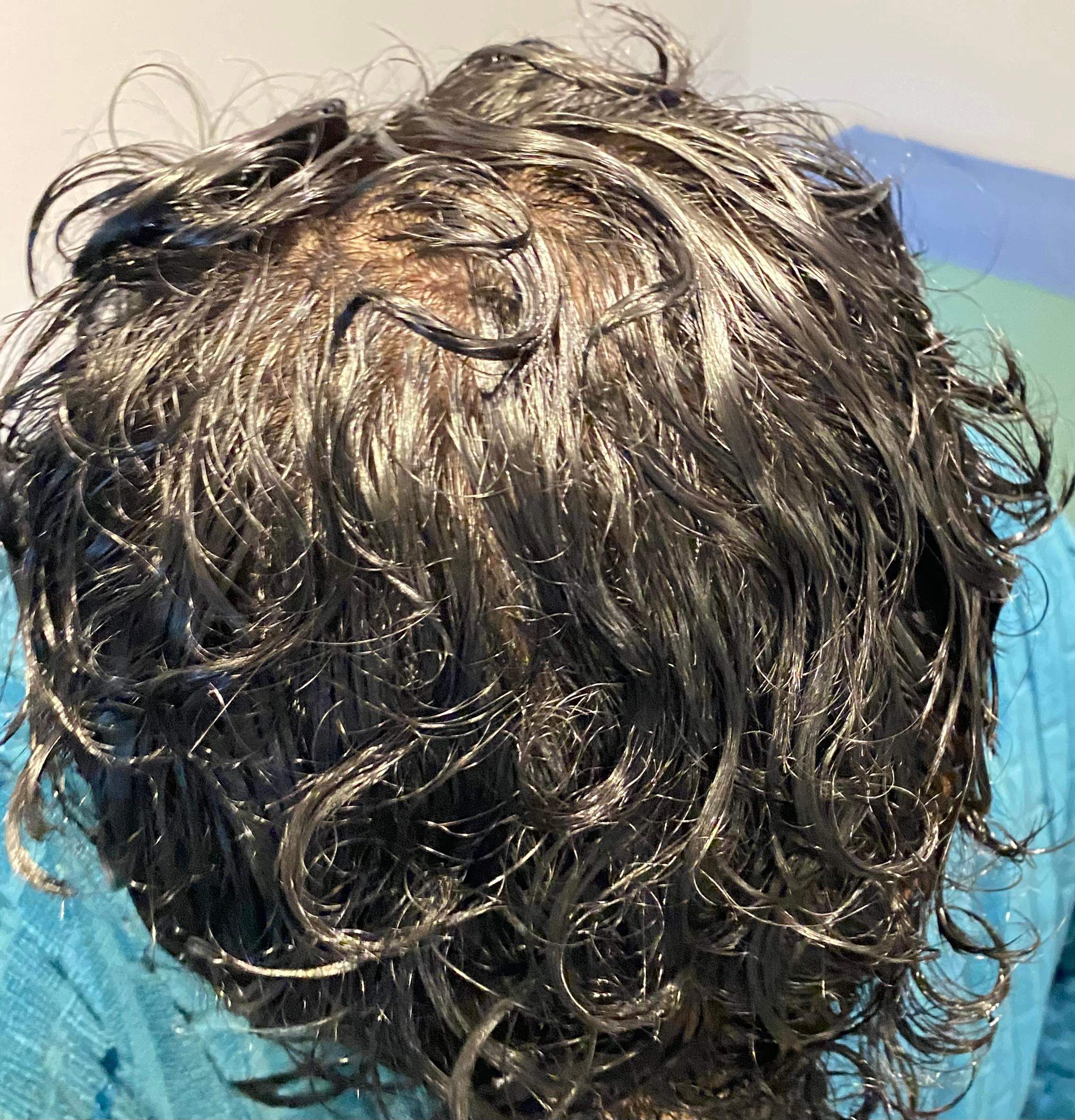 Haarausfall? (Männer, Aussehen, Kopfhaut)