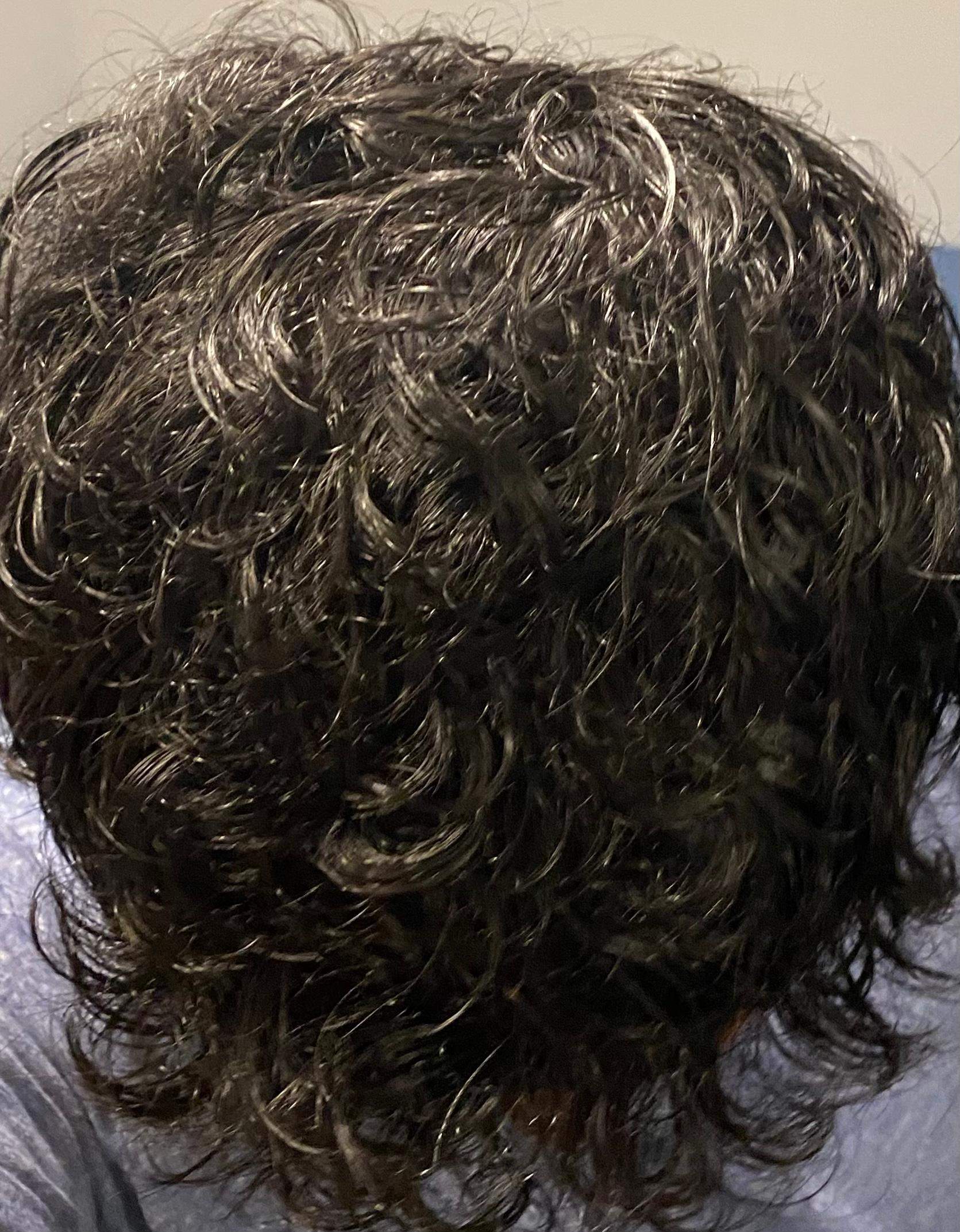 Haarausfall? (Männer, Aussehen, Kopfhaut)