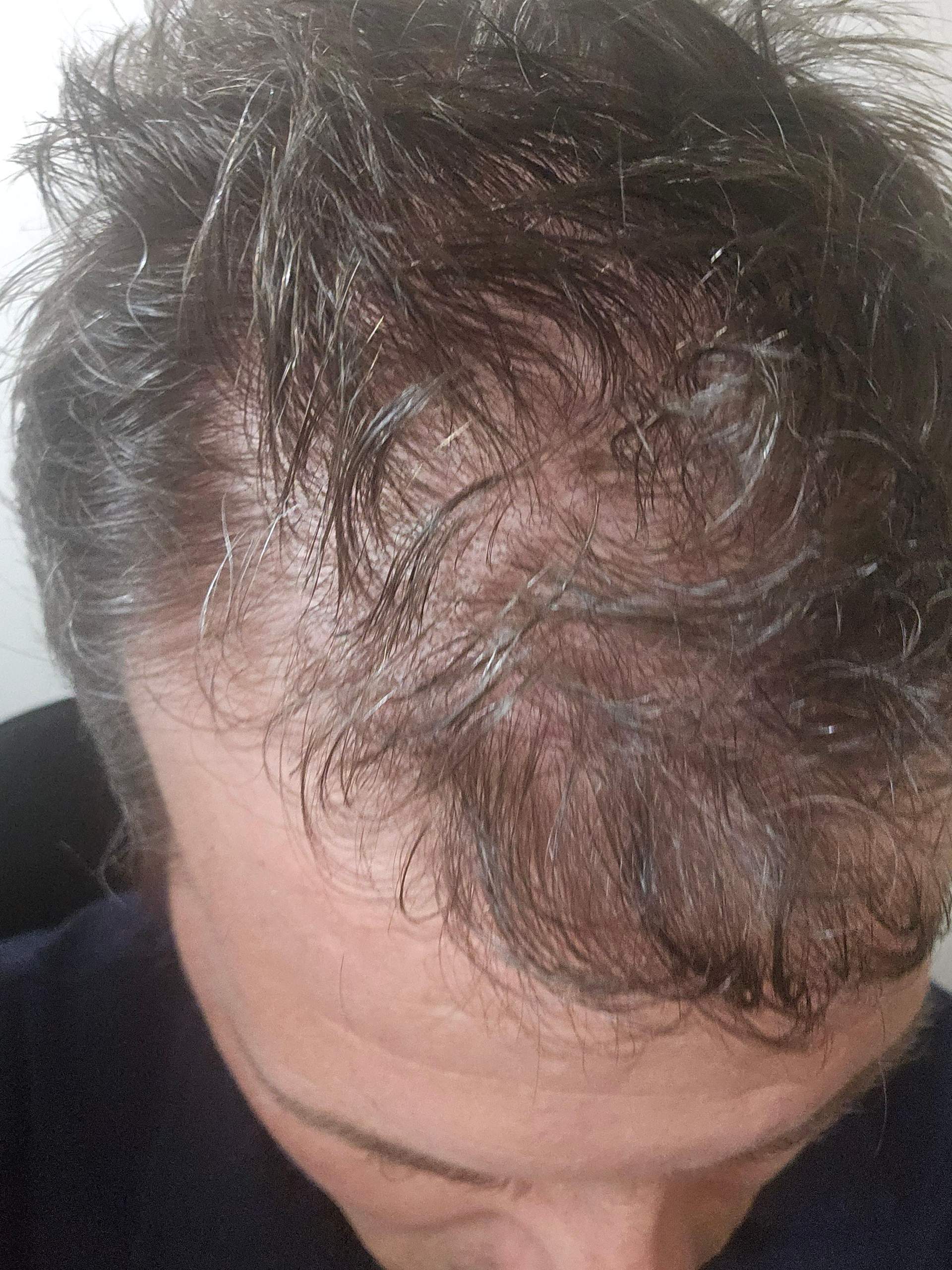Haarausfall und Hauptproblem, welche Frisur? (Mädchen, Frauen, Männer)