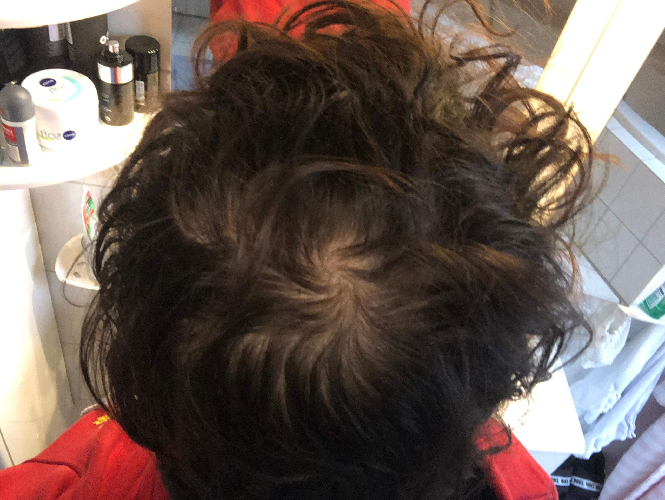 Haare abrasieren aber Haarausfall? (rasieren, Buzzcut)