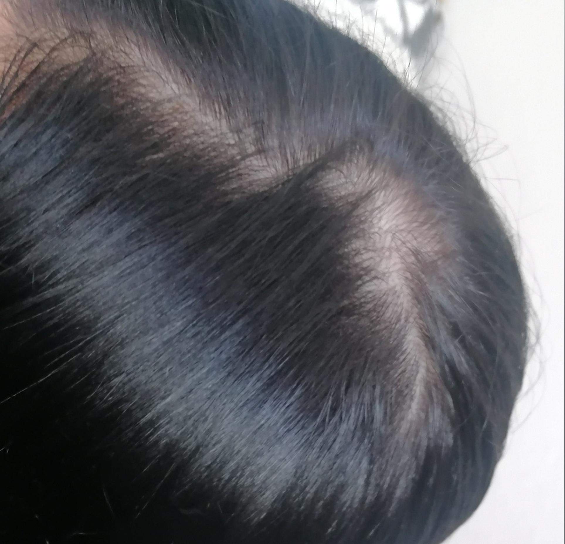 Haare werden immer dünner und lichter? (Haarausfall, Kopfhaut)