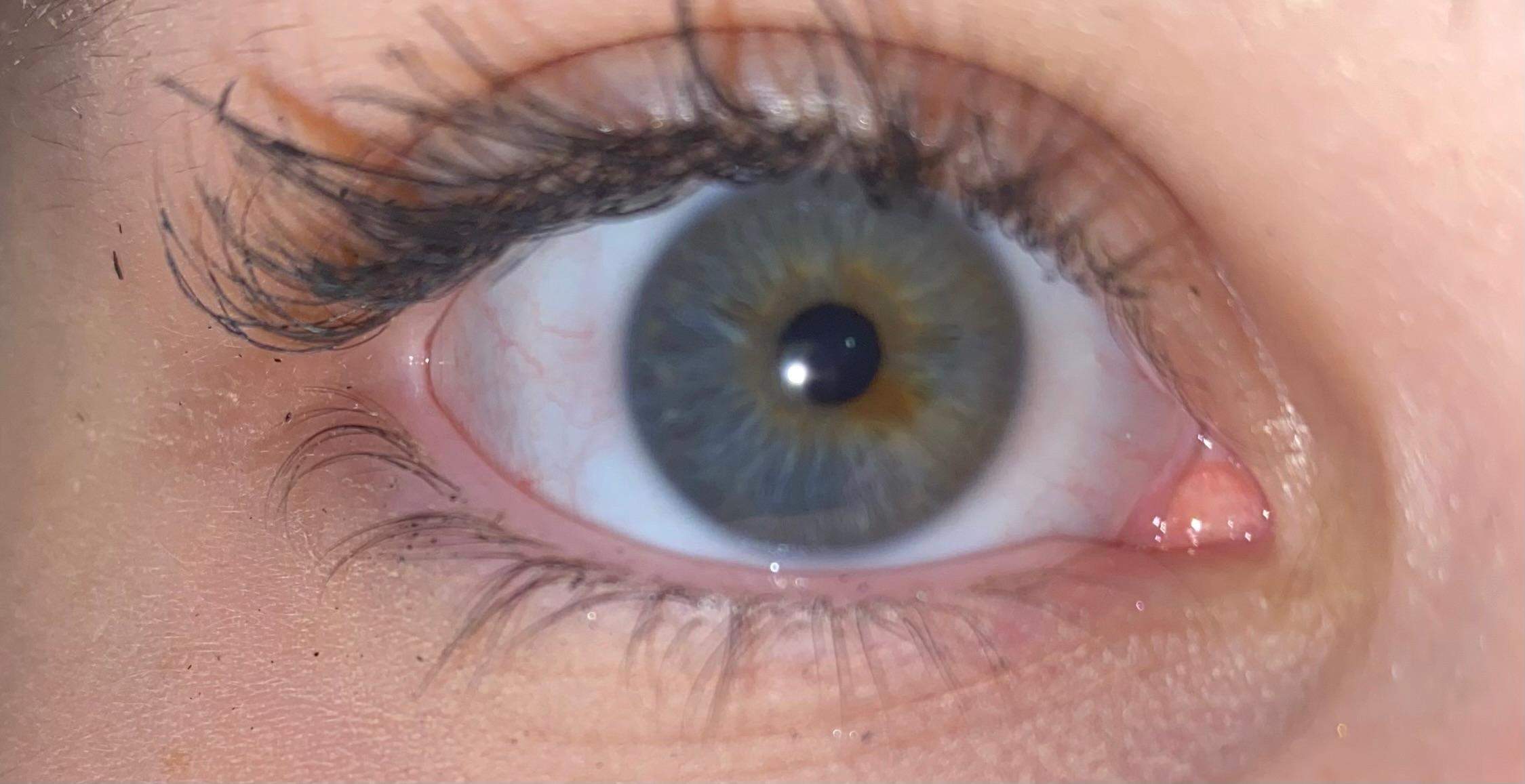 Hab ich zentrale Heterochromie? (Genetik, Augenfarbe, Iris)