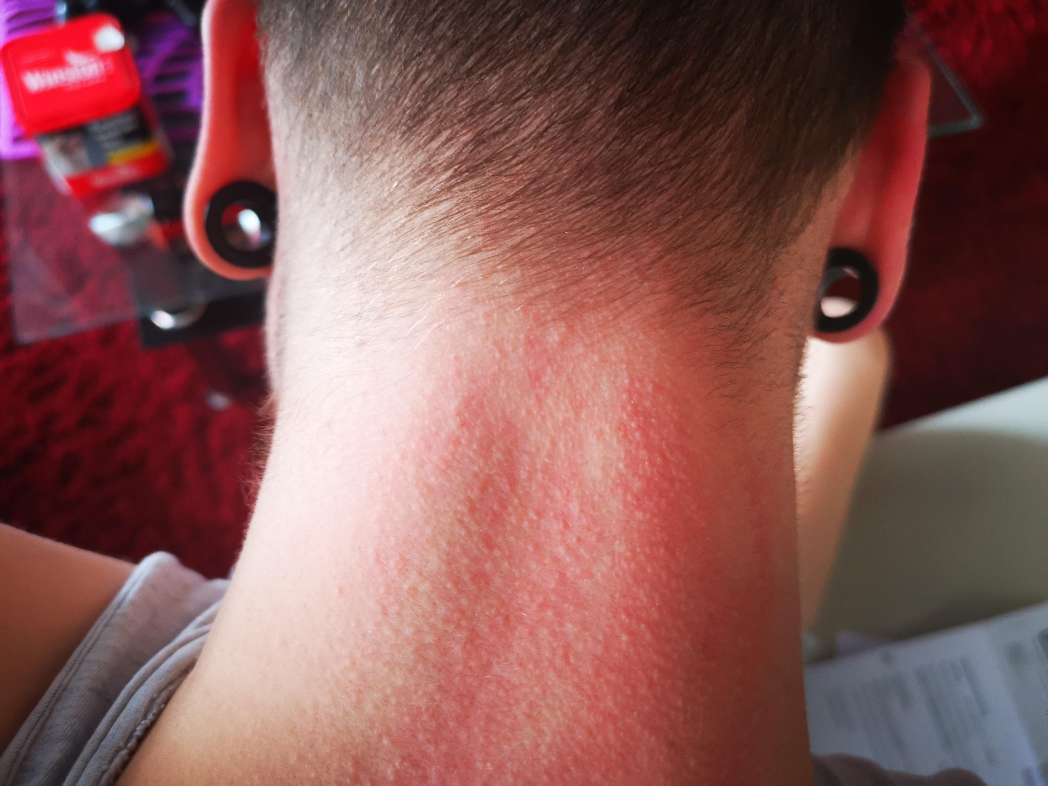 Habe am Nacken irgendwelche pusteln weiß jemand genau was das ist?Habe ...