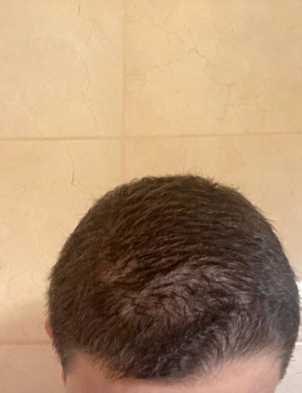 Habe ich dünnes Haar oder sorgar Haarausfall mit 15? (Haare)