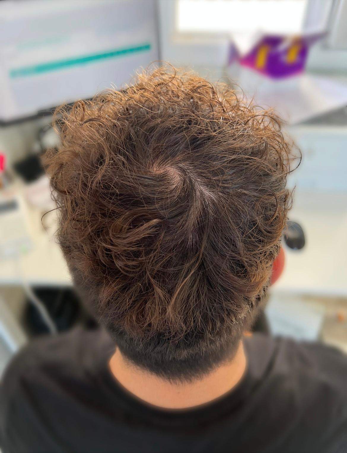 Habe ich Haarausfall am Hinterkopf? (Bilder)? (Dauerwelle)