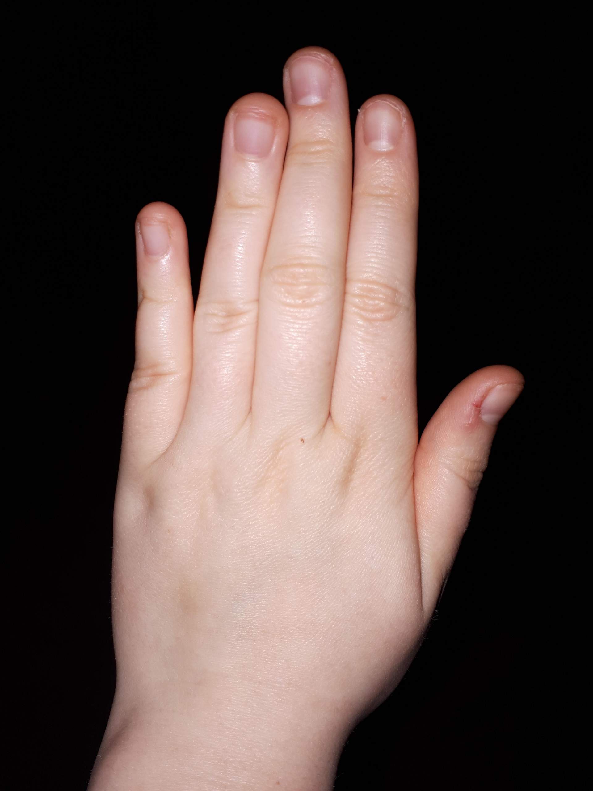 Habe ich (sehr) krumme Finger? (Körper, Hand, krumm)