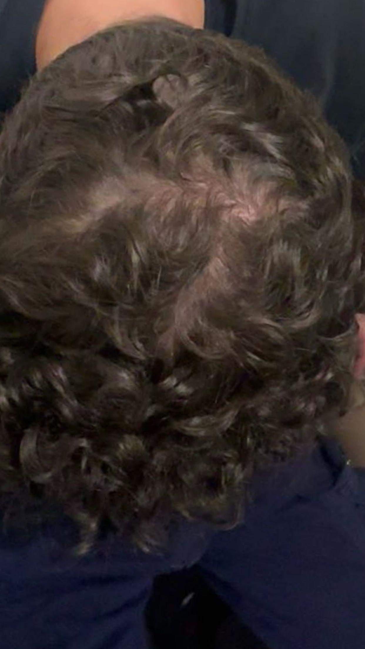 Hallo ich wollte mal fragen ob das Haarausfall ist? (Kopfhaut)
