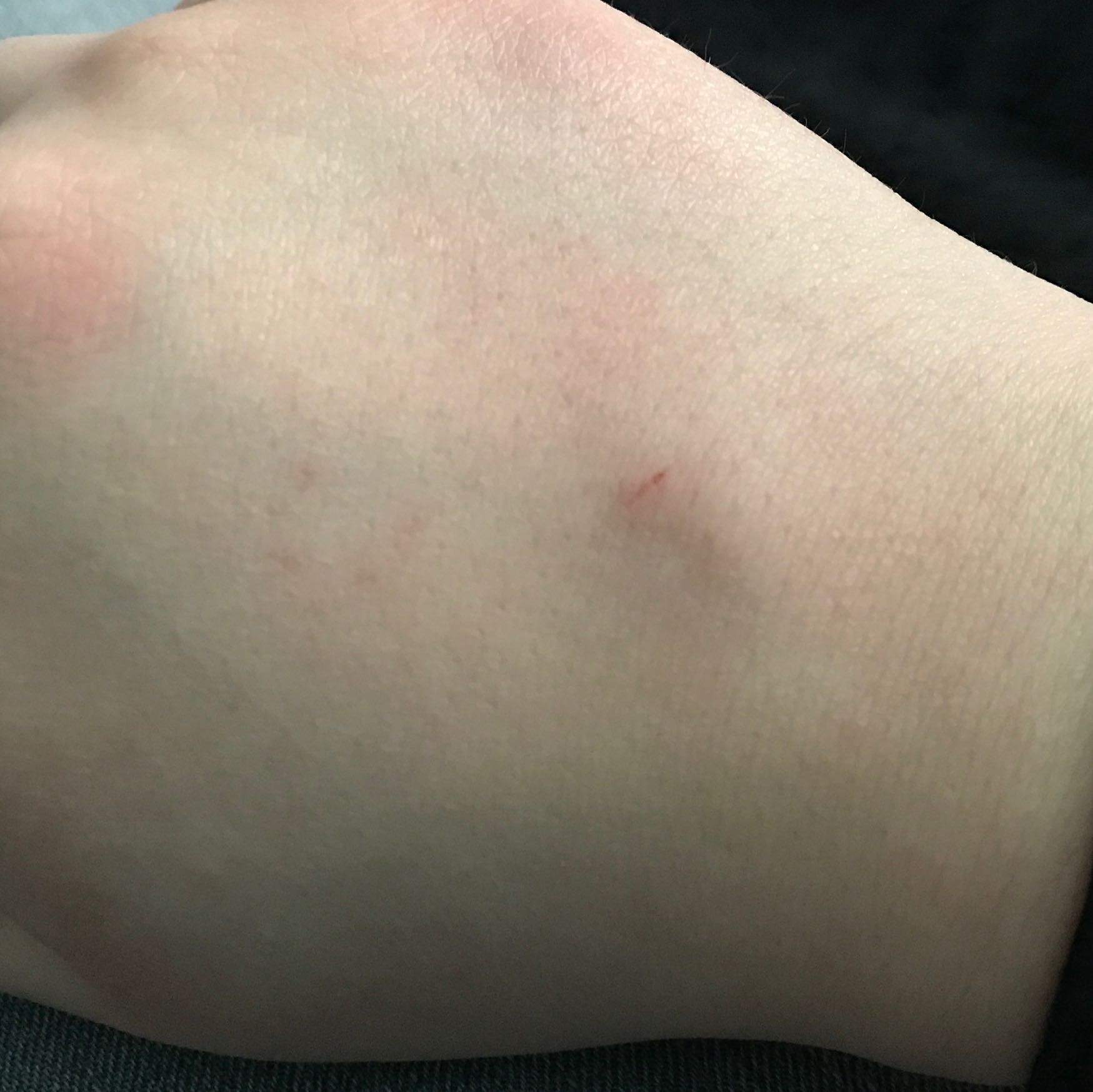 Hand angeschwollen beule .. zum Arzt ja oder nein? (Gesundheit und ...