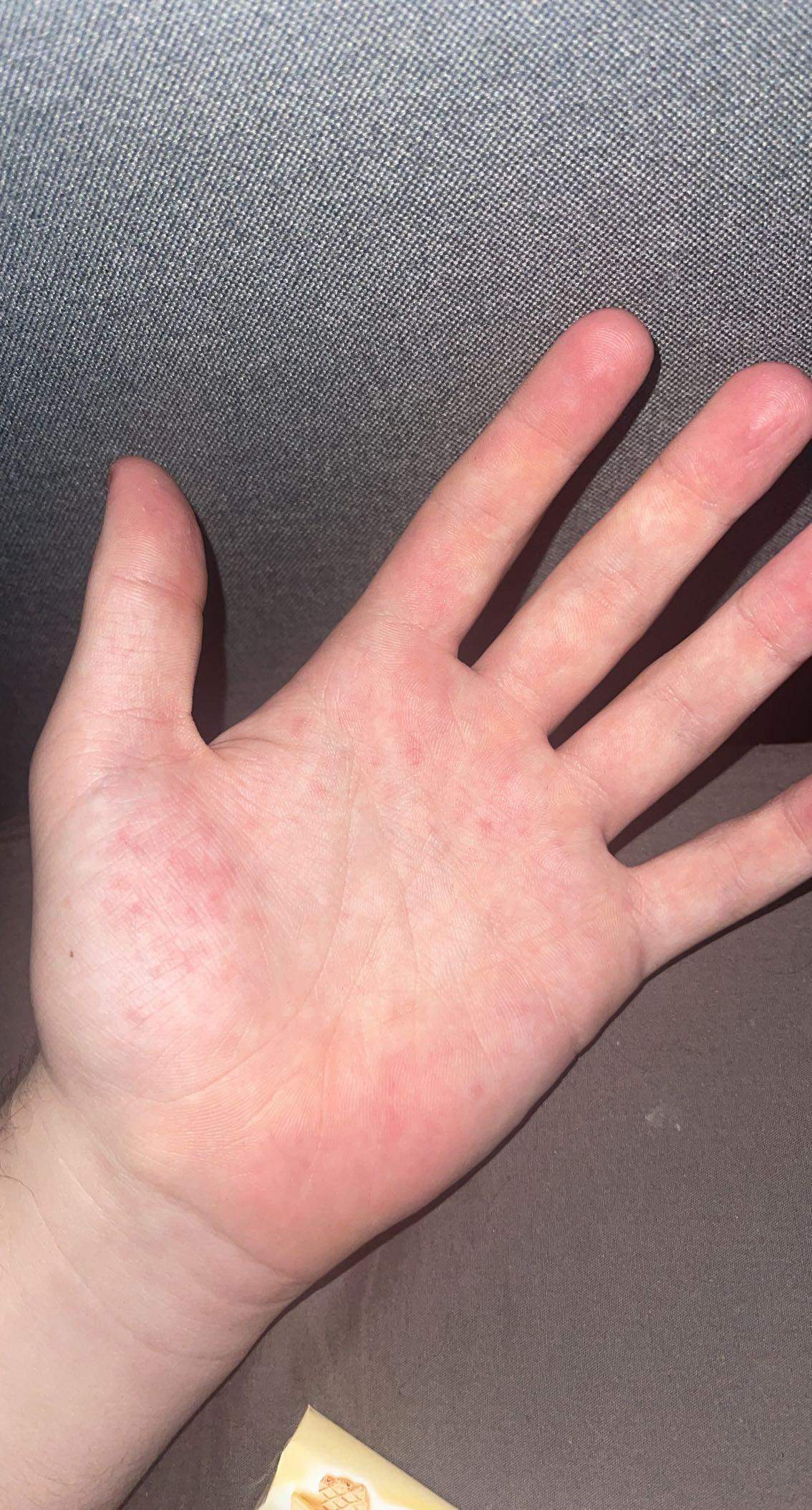 Hand Fläche rot und gepunktet von innen? (Gesundheit und Medizin)