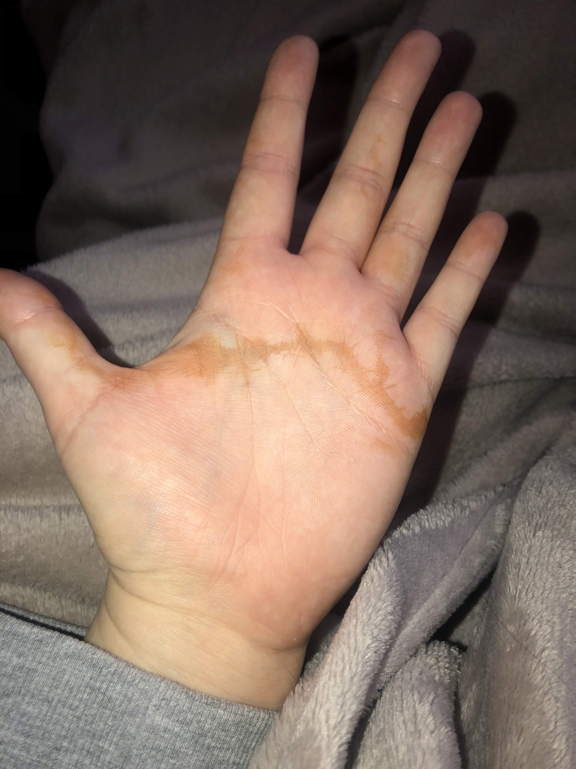 Hand hat sich verfärbt? (Gesundheit und Medizin, Verfärbung, Arzttermin)