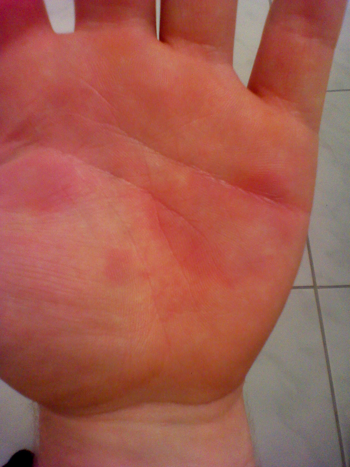 Harte, dunkle und juckende Stellen auf den Handinnenflächen - was kann ...