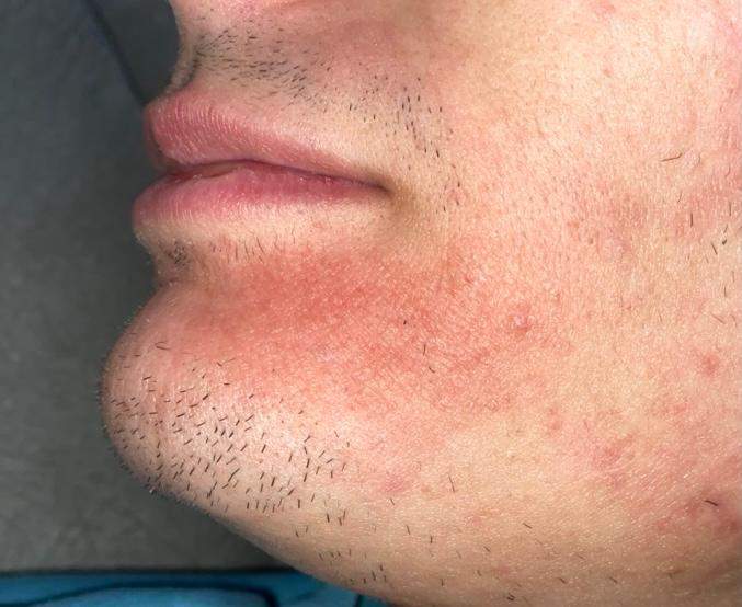 Hautpilz im Gesicht? (Gesundheit und Medizin, Gesundheit, Hautprobleme)