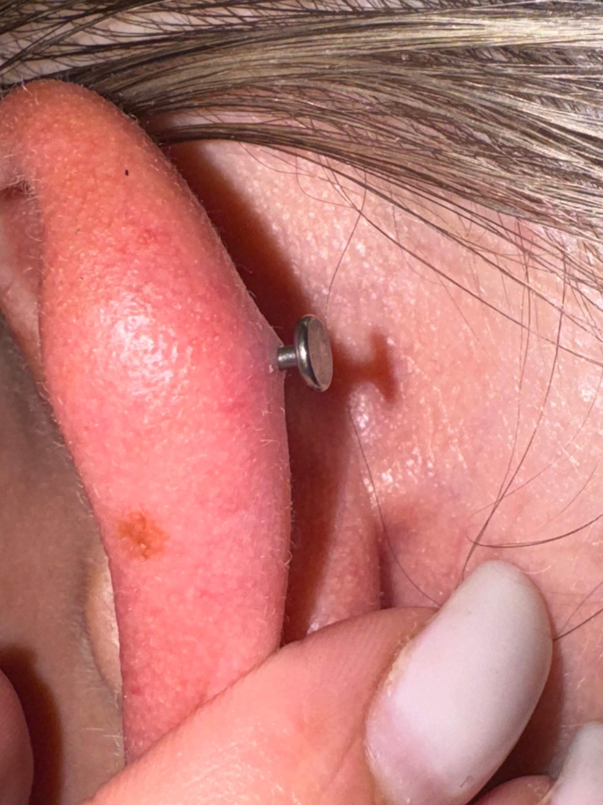 Helix Piercing 10 Wochen alt sieht normal aus Heilung oder ist das ...