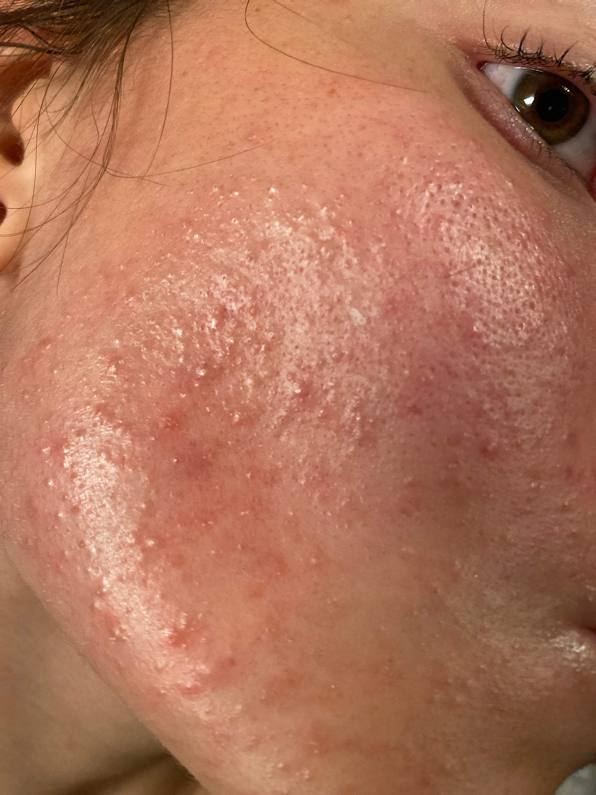 Hilfe bei Hautproblem (Akne/Milien)? (Gesundheit und Medizin, Haut, Pille)