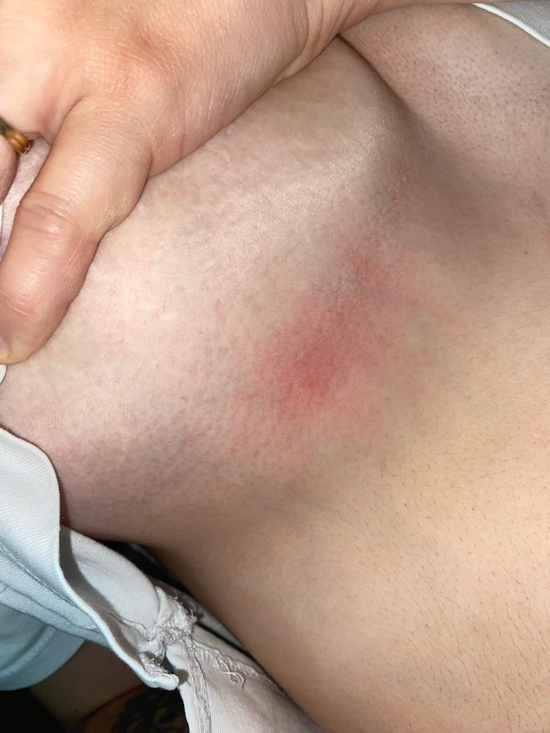 Hilfe Bisse auf der Haut u. Hautausschläge? (Medizin, Hautarzt, Ausschlag)