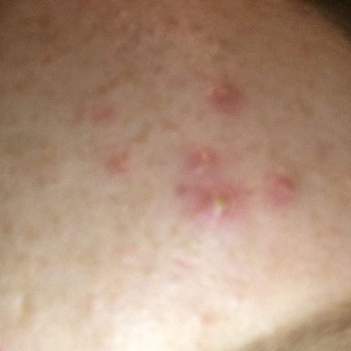 HILFE ich habe so schlimme eklige Pickel auf meiner Stirn? (Gesundheit ... HILFE ich habe so schlimme eklige Pickel auf meiner Stirn? (Gesundheit ...