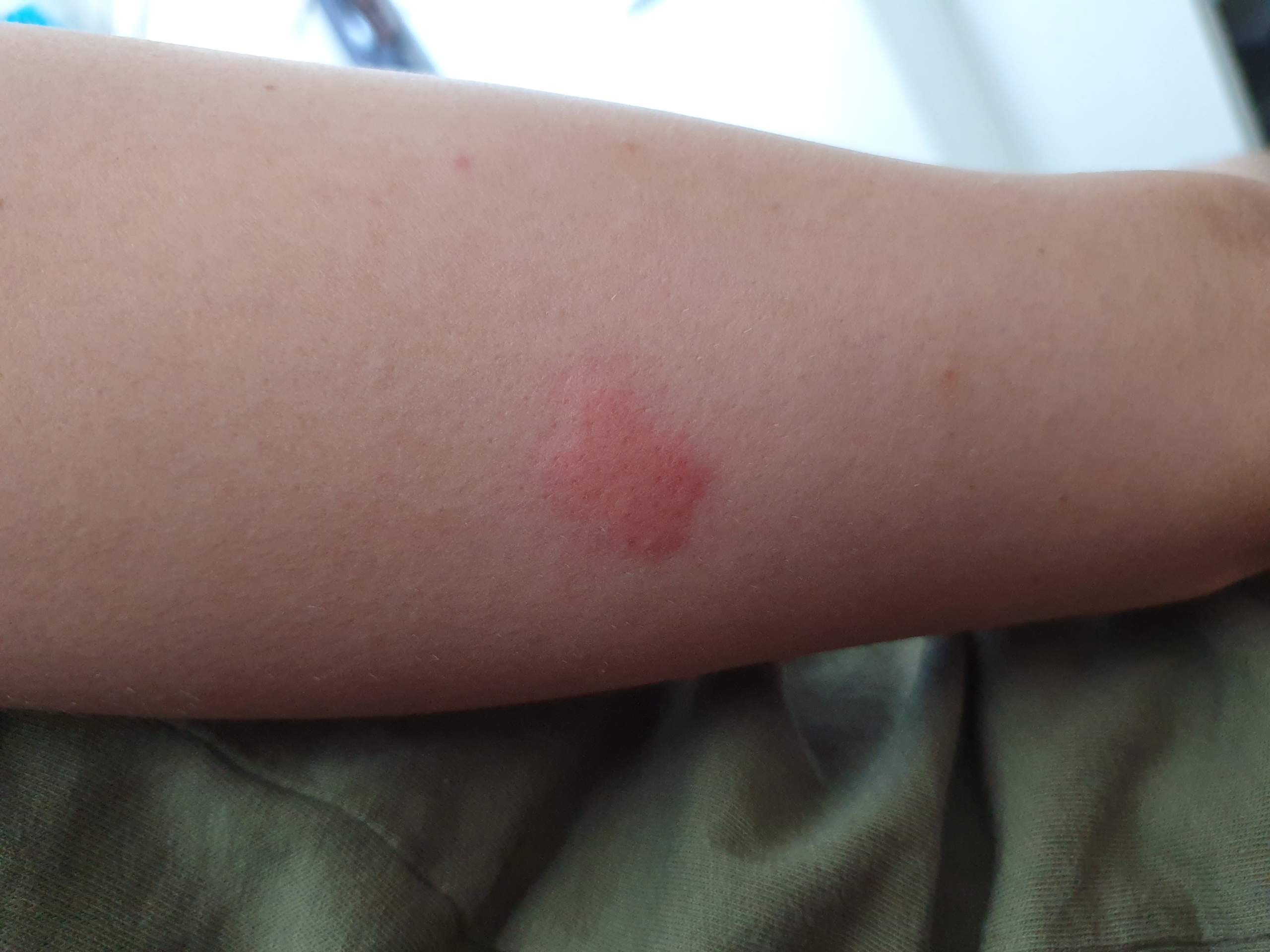 Hilfe! Roter Fleck Unterarm, heisser Fleck was tun? (Gesundheit, Haut ...