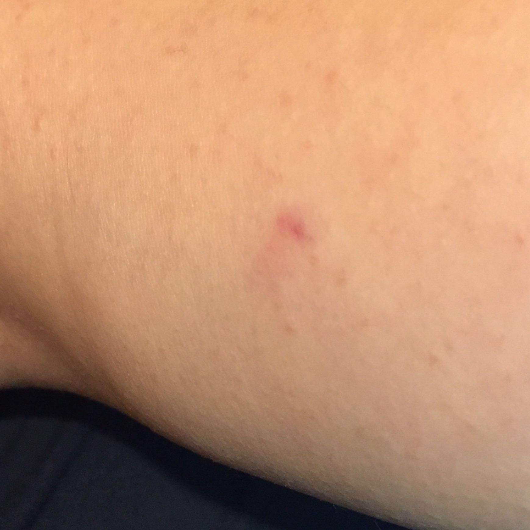 Hilfe,weis jemand ob das Hautrisse sind oder Anfänge von Risse ...