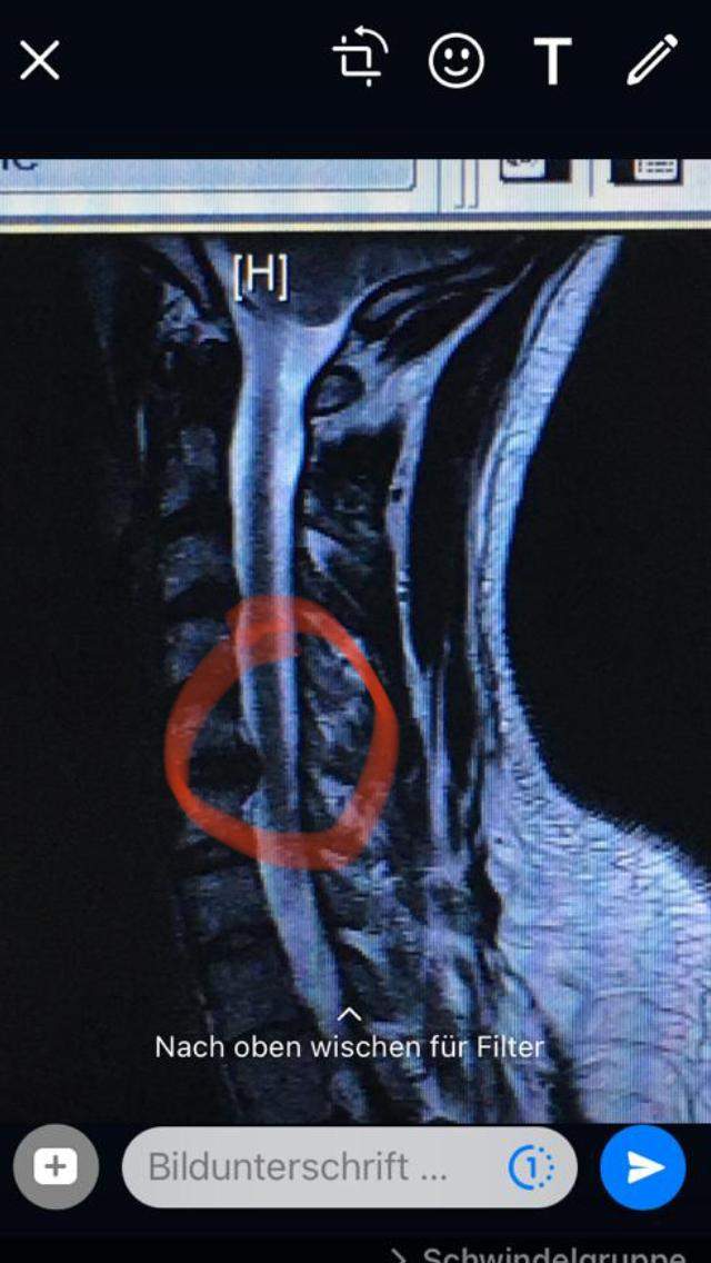 Hws mrt ist das ein Riesen Bandscheibenvorfall? (Medizin, Radiologie)