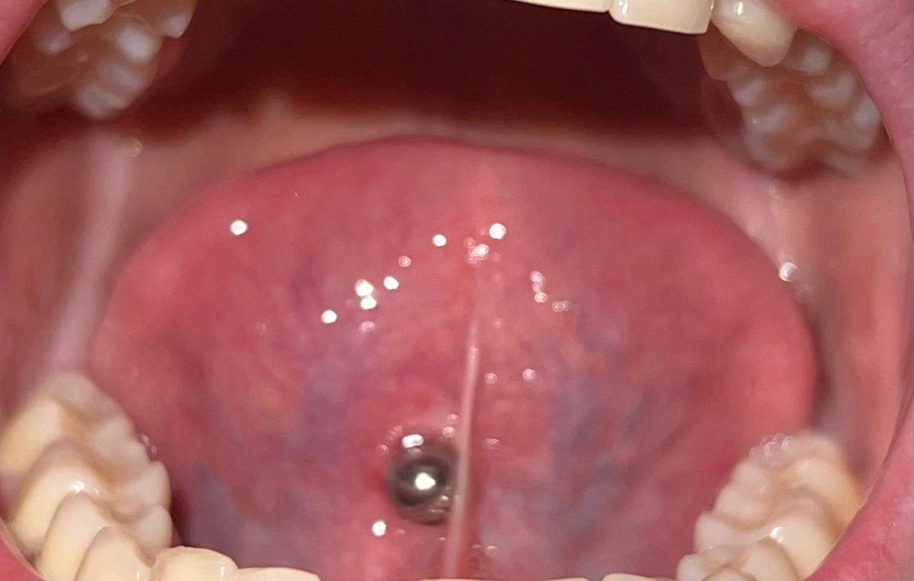 Piercing Kugel Verschluckt