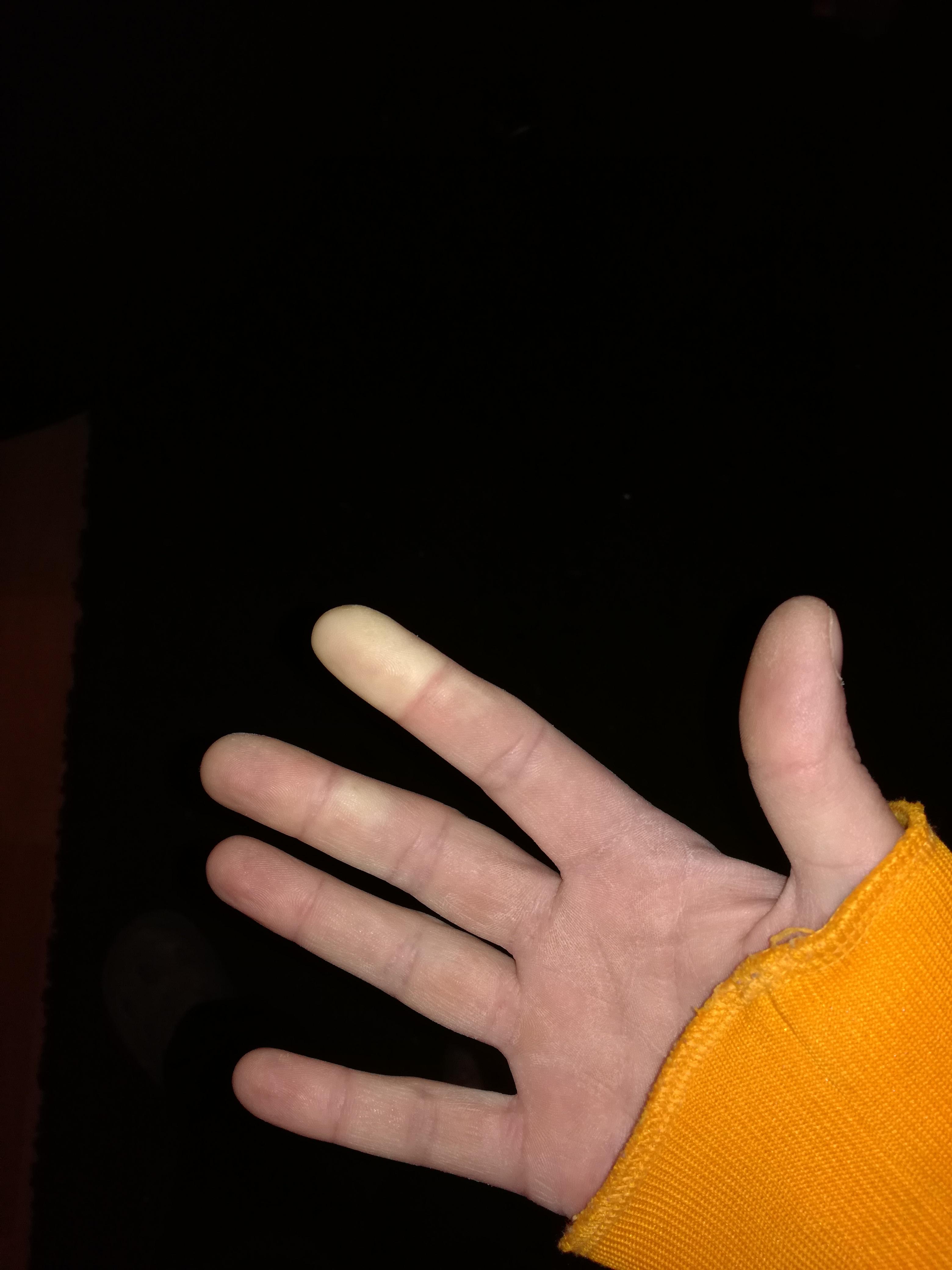 Immer wiederkehrende durchblutungsstörungen und taubheitsgefühl in den ...