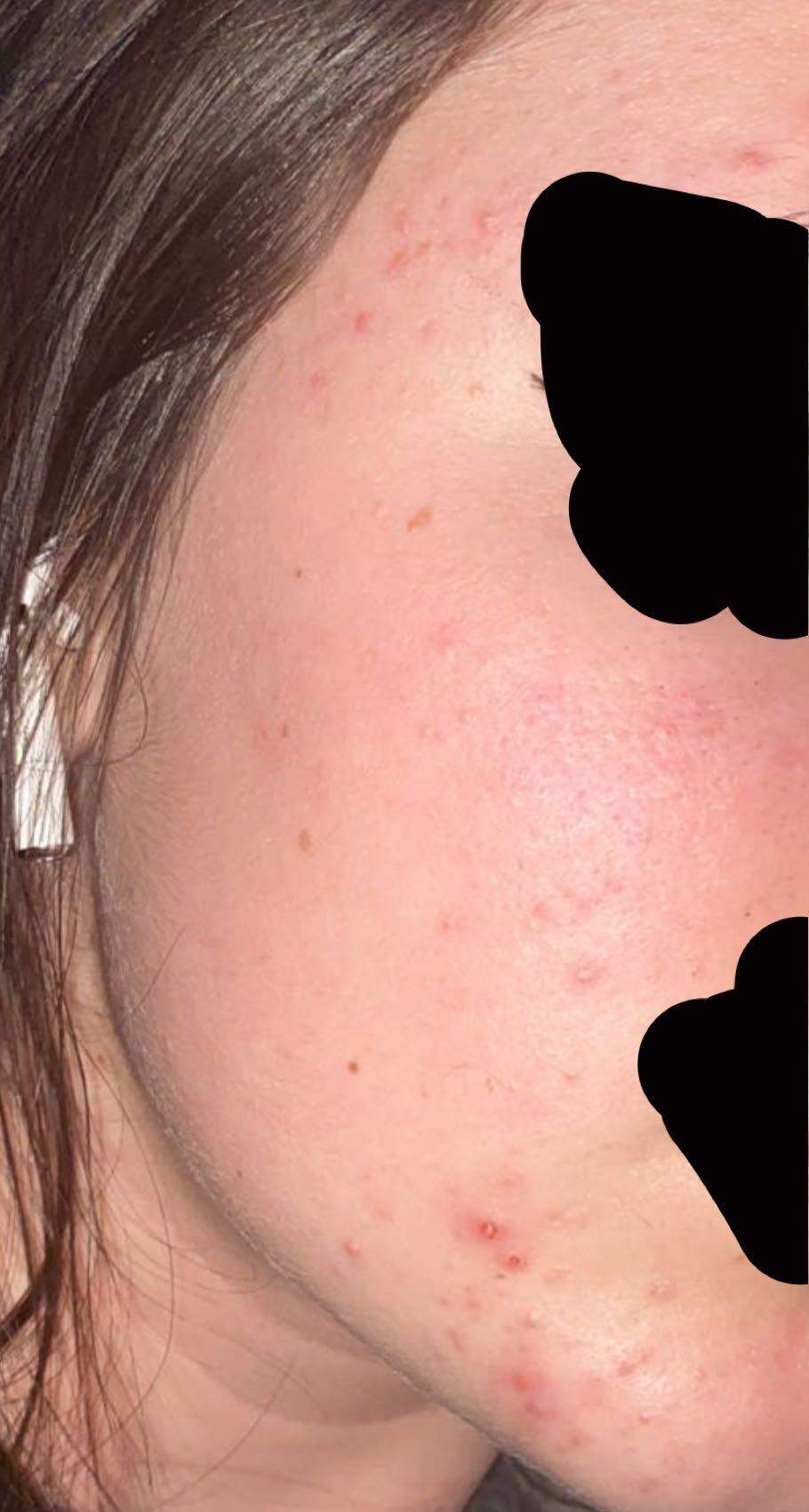 Ist das der Anfang einer Akne? (Haut, Pickel)