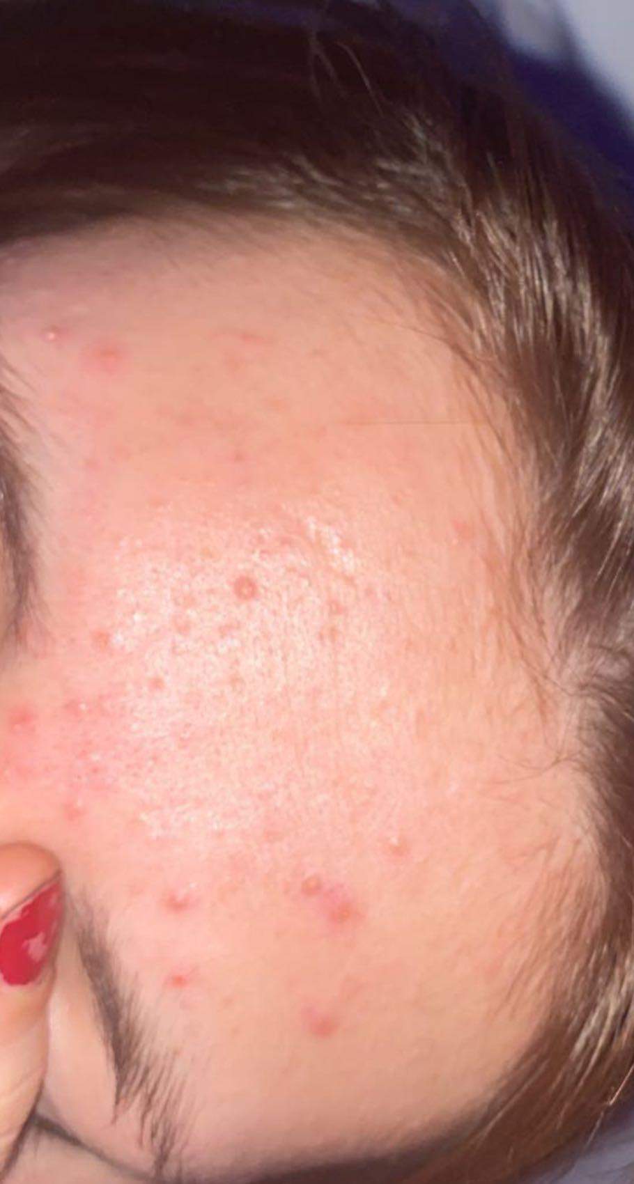 Ist das der Anfang einer Akne? (Haut, Pickel)