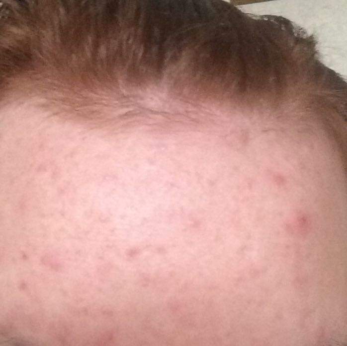 Ist das der Anfang von Akne? (Haut)