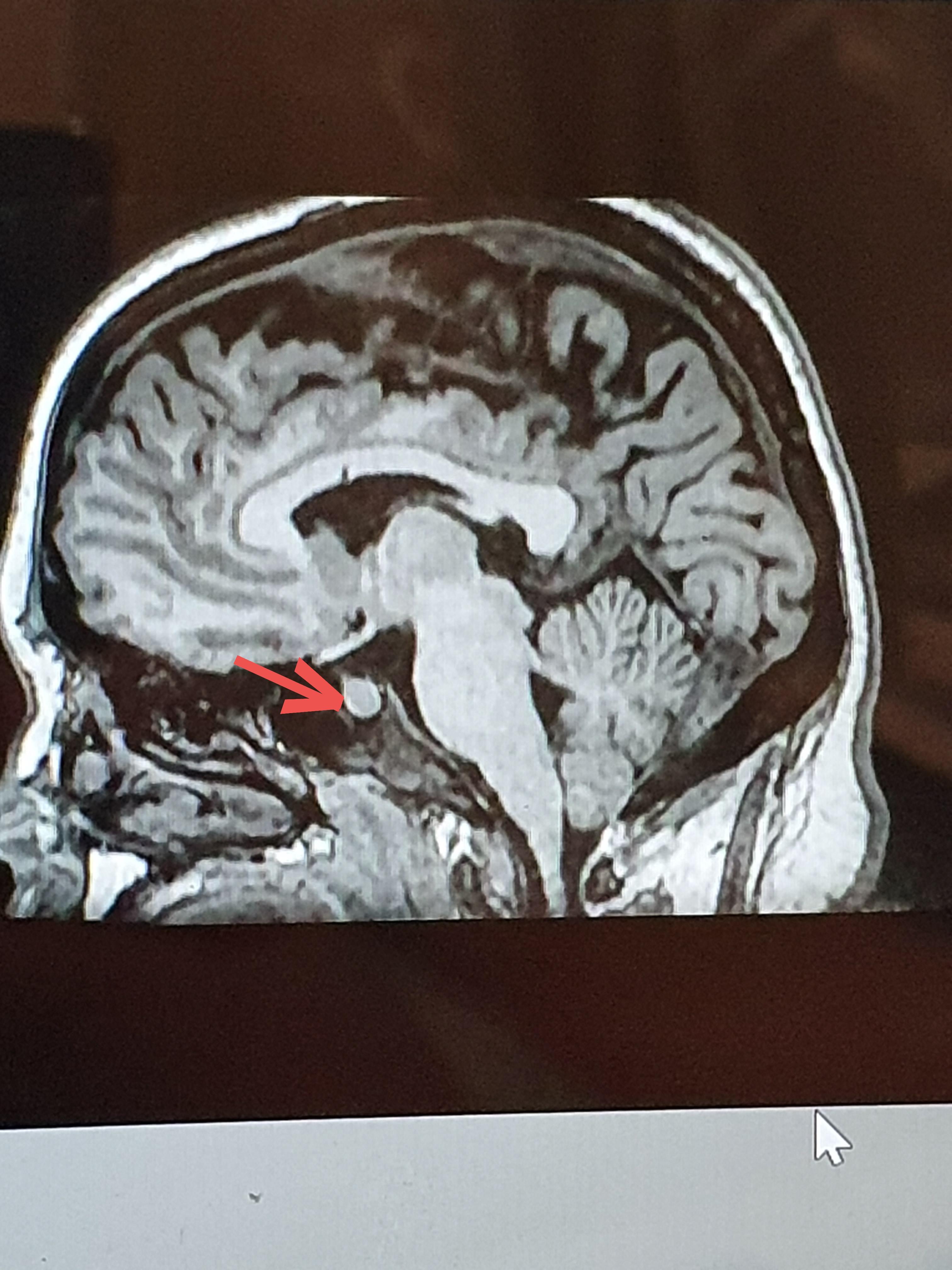 Ist das ein Hirntumor (Hypophysenadenom)? (Medizin, Studium, MRT)