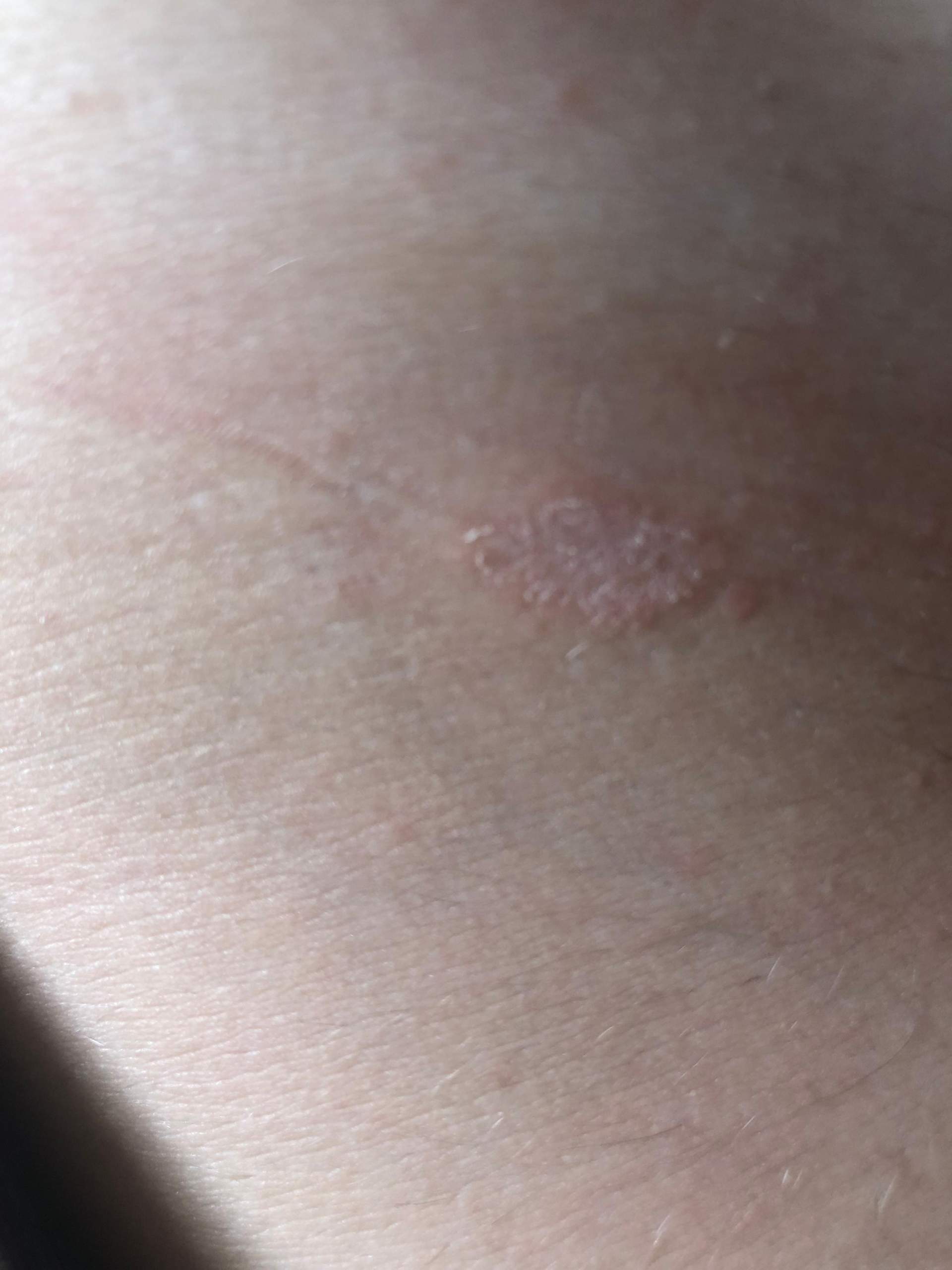 Ist das ein Mückenstich, Flohbiss, Milbenbiss, Krätze oder so ...