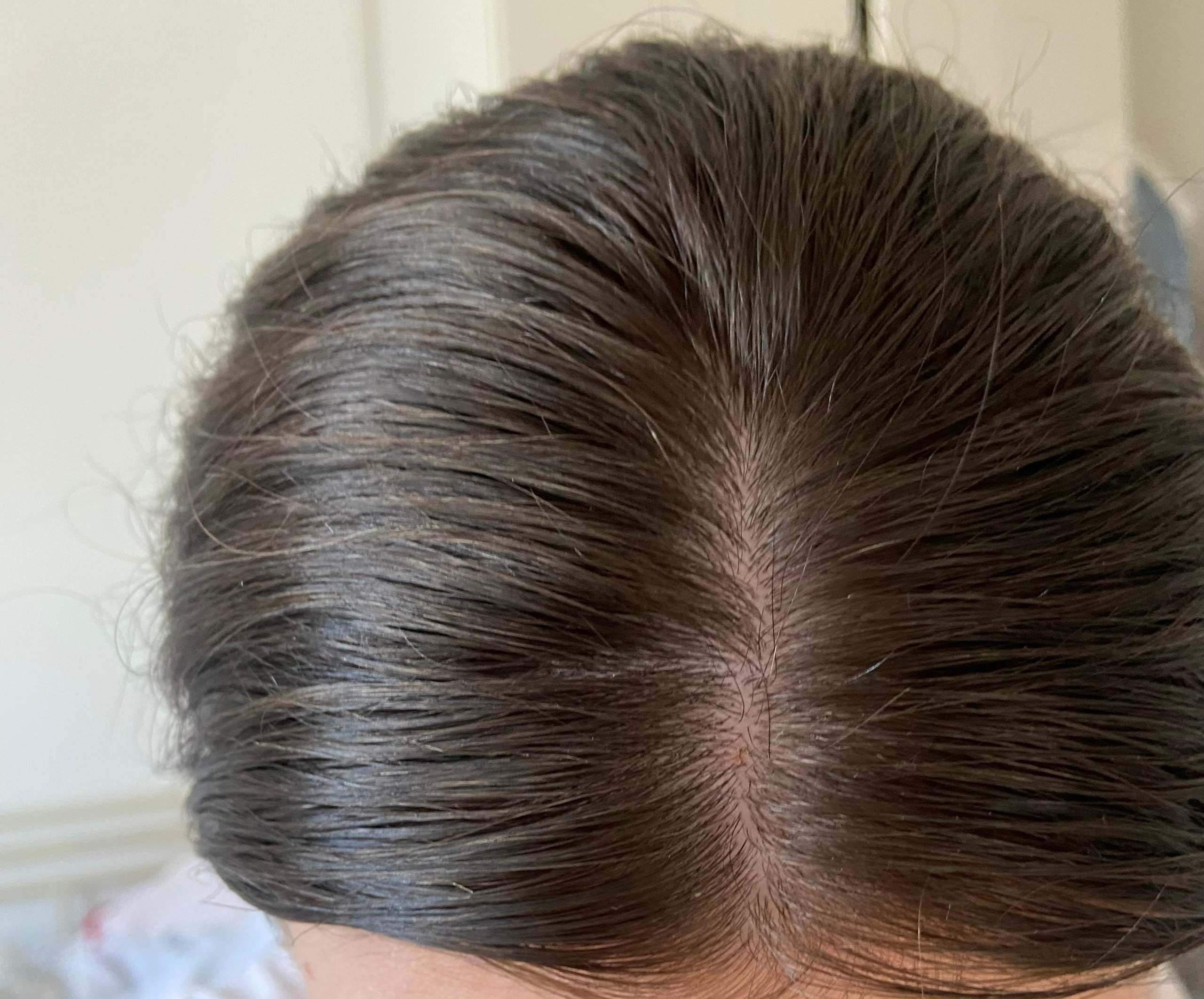 Ist das ein normaler Scheitel?hilfe? (Aussehen, Haarpflege, Haarausfall)