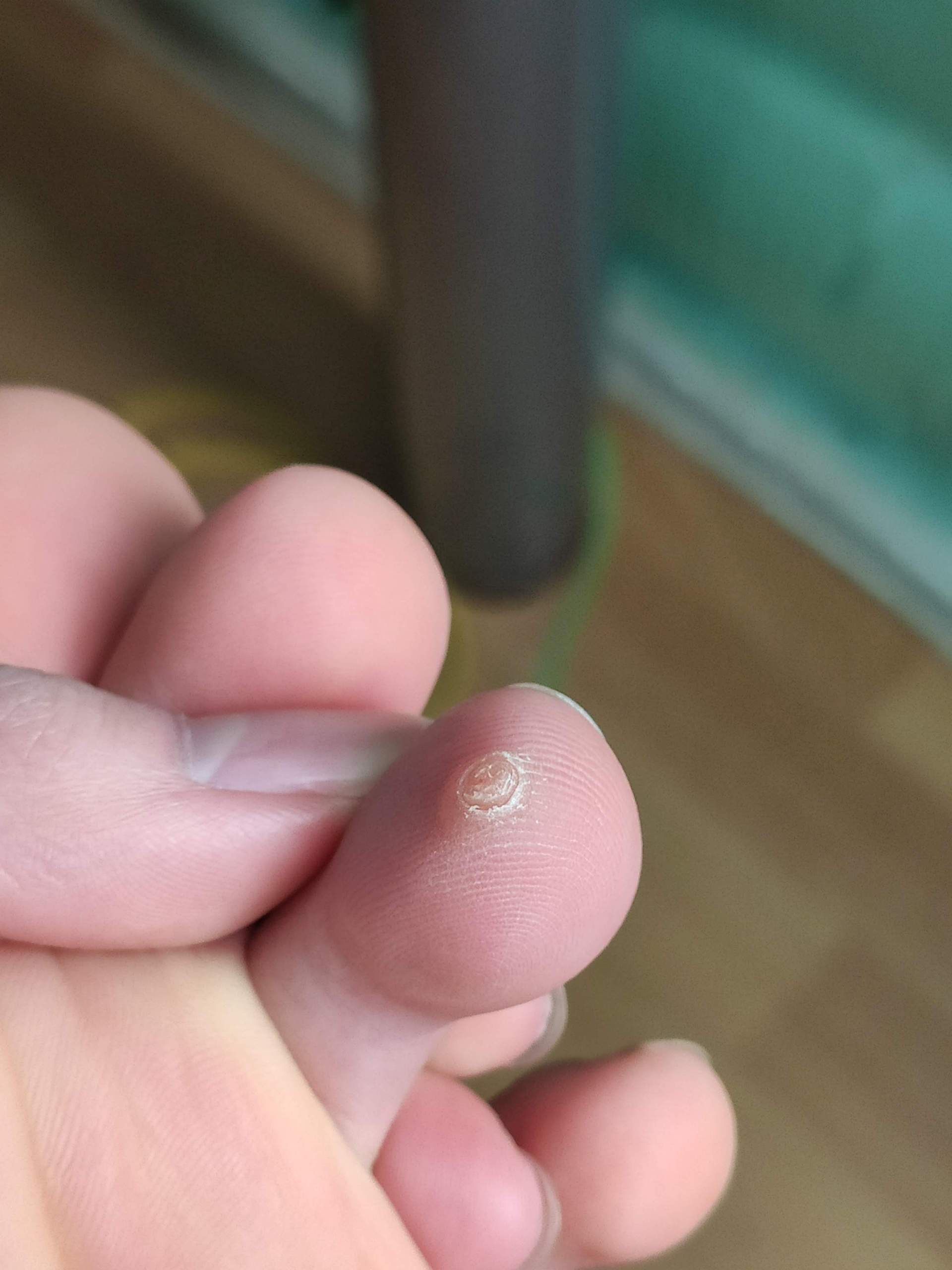 Ist das eine Warze am Zeh? und wie werde ich das los? (Gesundheit ... Ist das eine Warze am Zeh? und wie werde ich das los? (Gesundheit ...