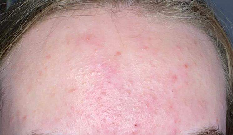 Ist das fungal Akne was ich habe? (Haut, Pickel, Fungal Acne)