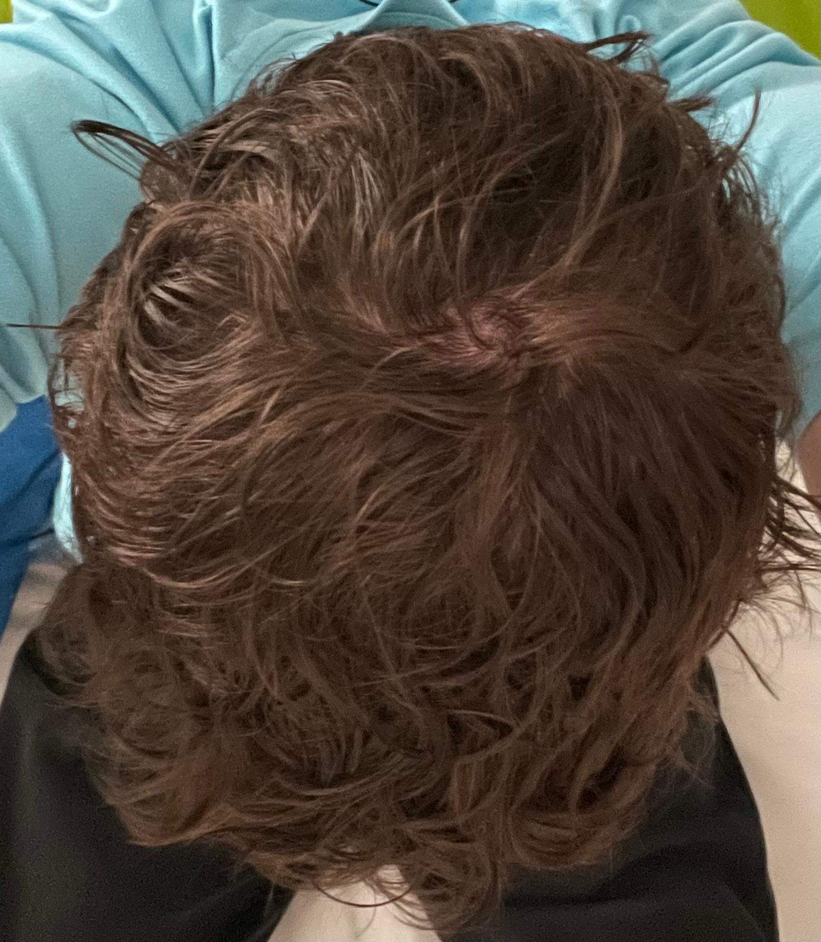 Ist das Haarausfall oder Normal? (Kopfhaut)
