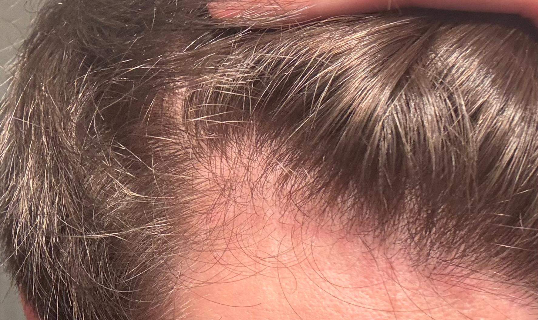 Ist das Haarausfall oder sind das Geheimratsecken? (Haarpflege ...