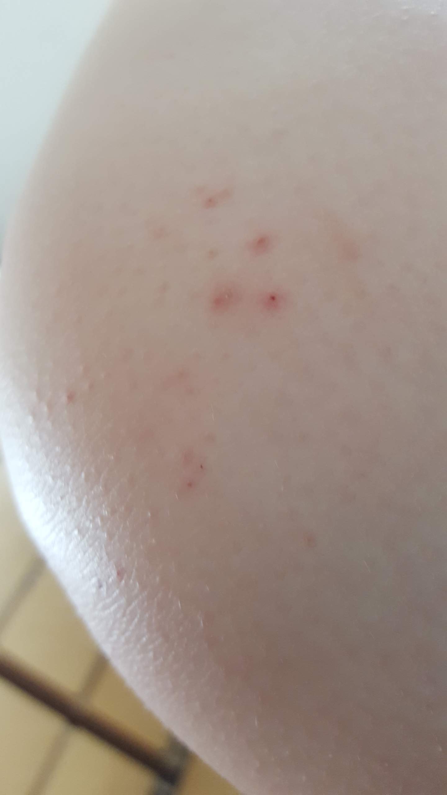Ist das Krätze (scabies), Hormone, Neurodermitis ? (Gesundheit und Medizin)