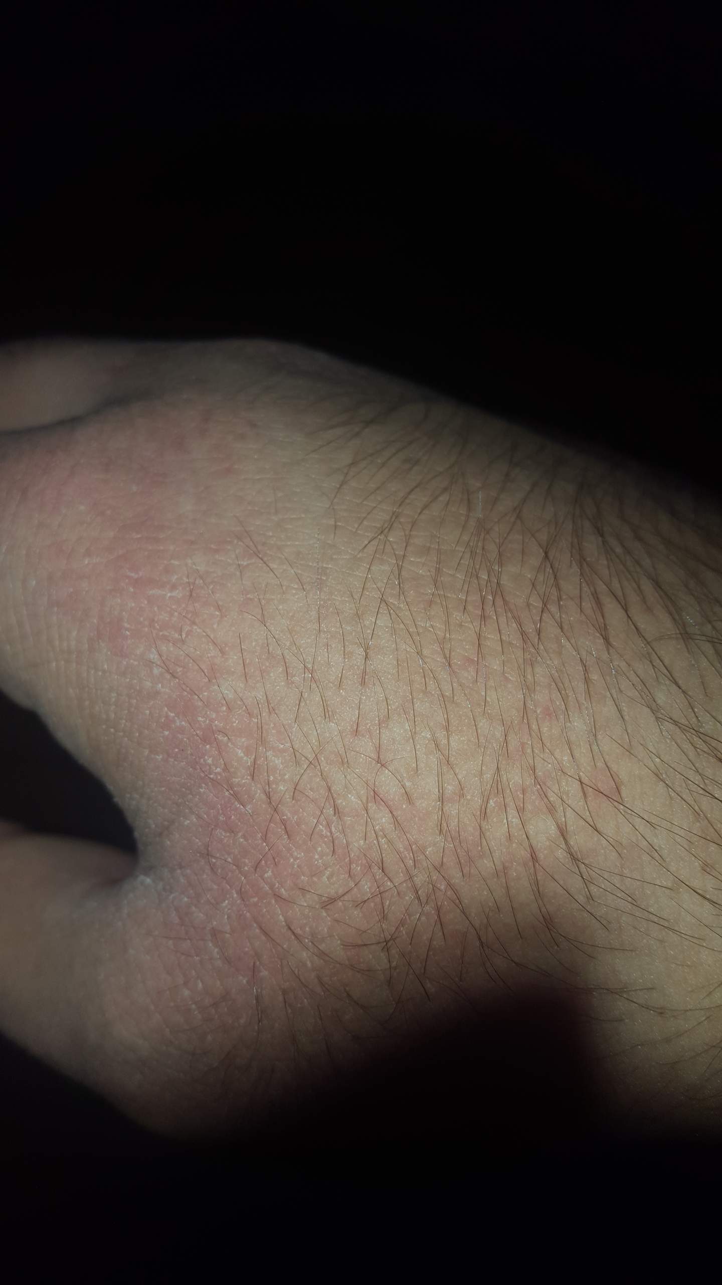 Ist das Krätze (Scabies)? (Gesundheit, Krankheit, Haut)