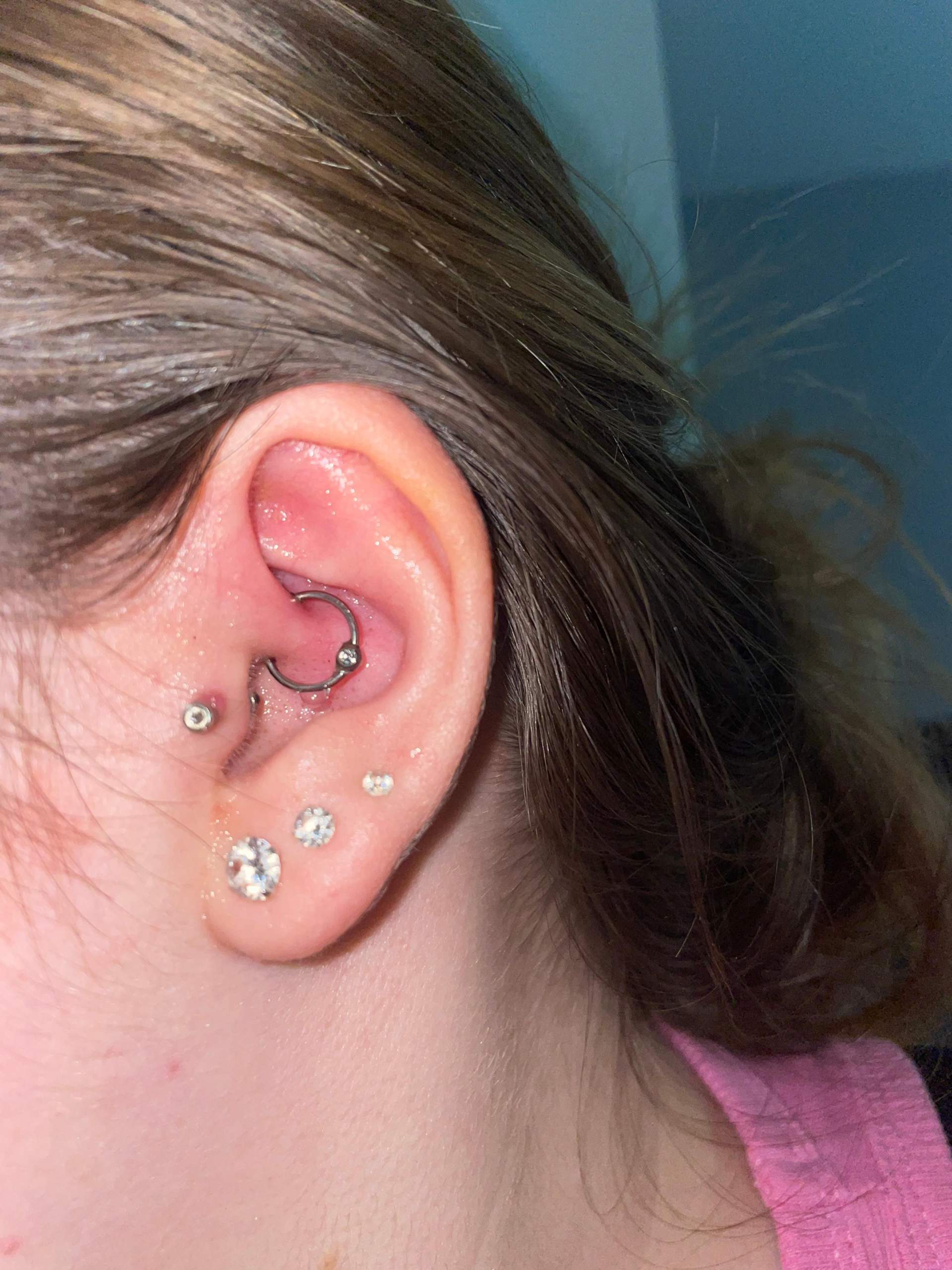 Ist das normal bei einem daith Piercing? (Schmerzen, Entzündung, Ohr)