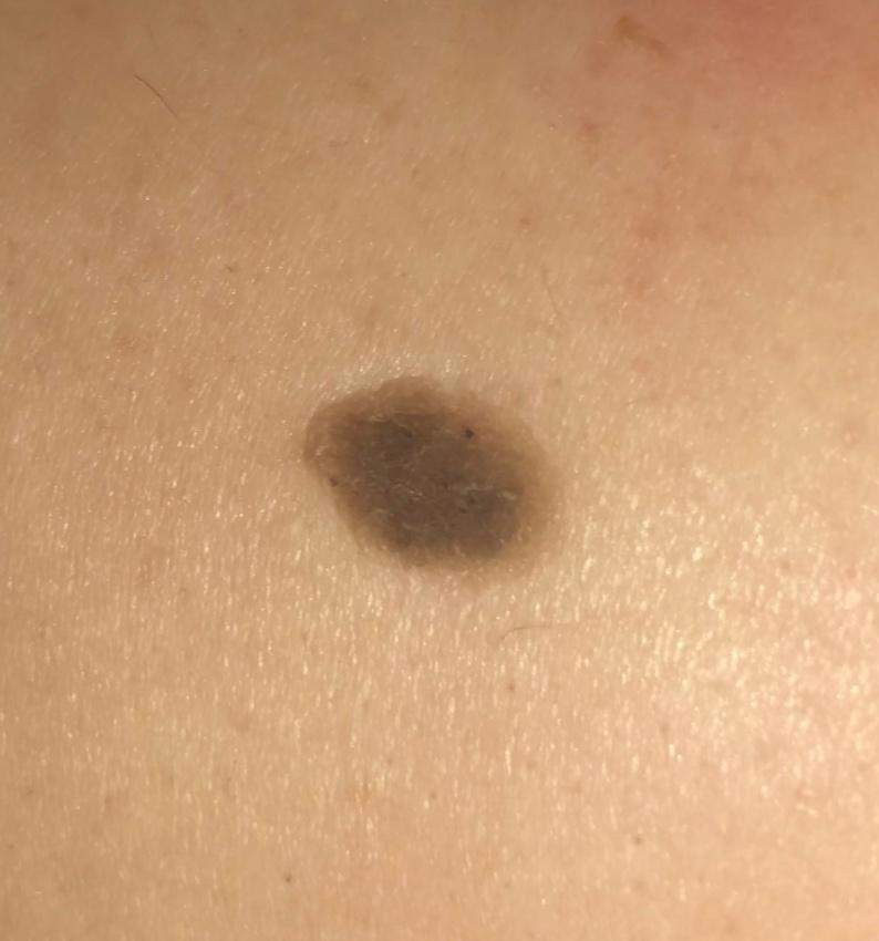 Ist das normal, seltsames Muttermal? (Haut)